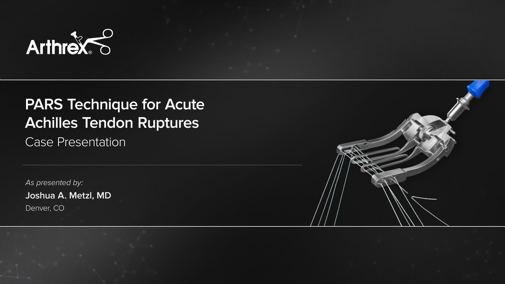 Arthrex - PARS Technique for Acute Achilles Tendon Ruptures