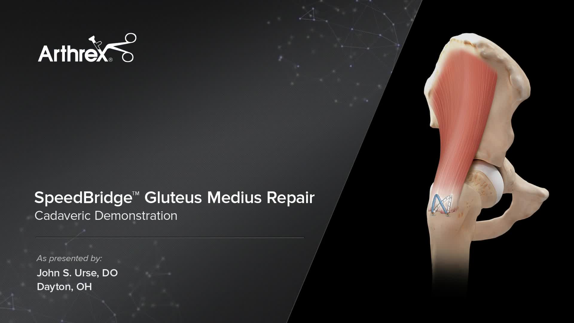 Arthrex - SpeedBridge™ Gluteus Medius Repair