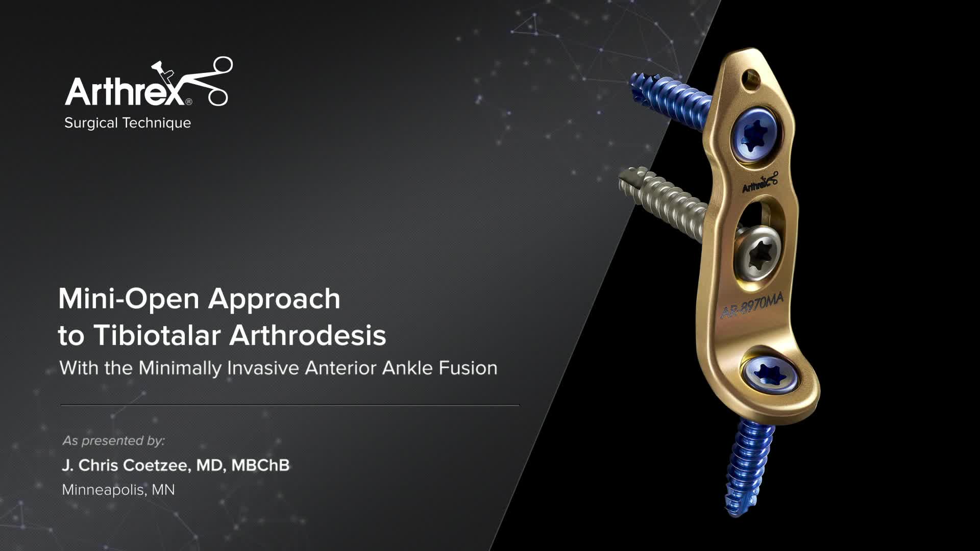 Arthrex - Mini-Open Approach to Tibiotalar Arthrodesis With the ...