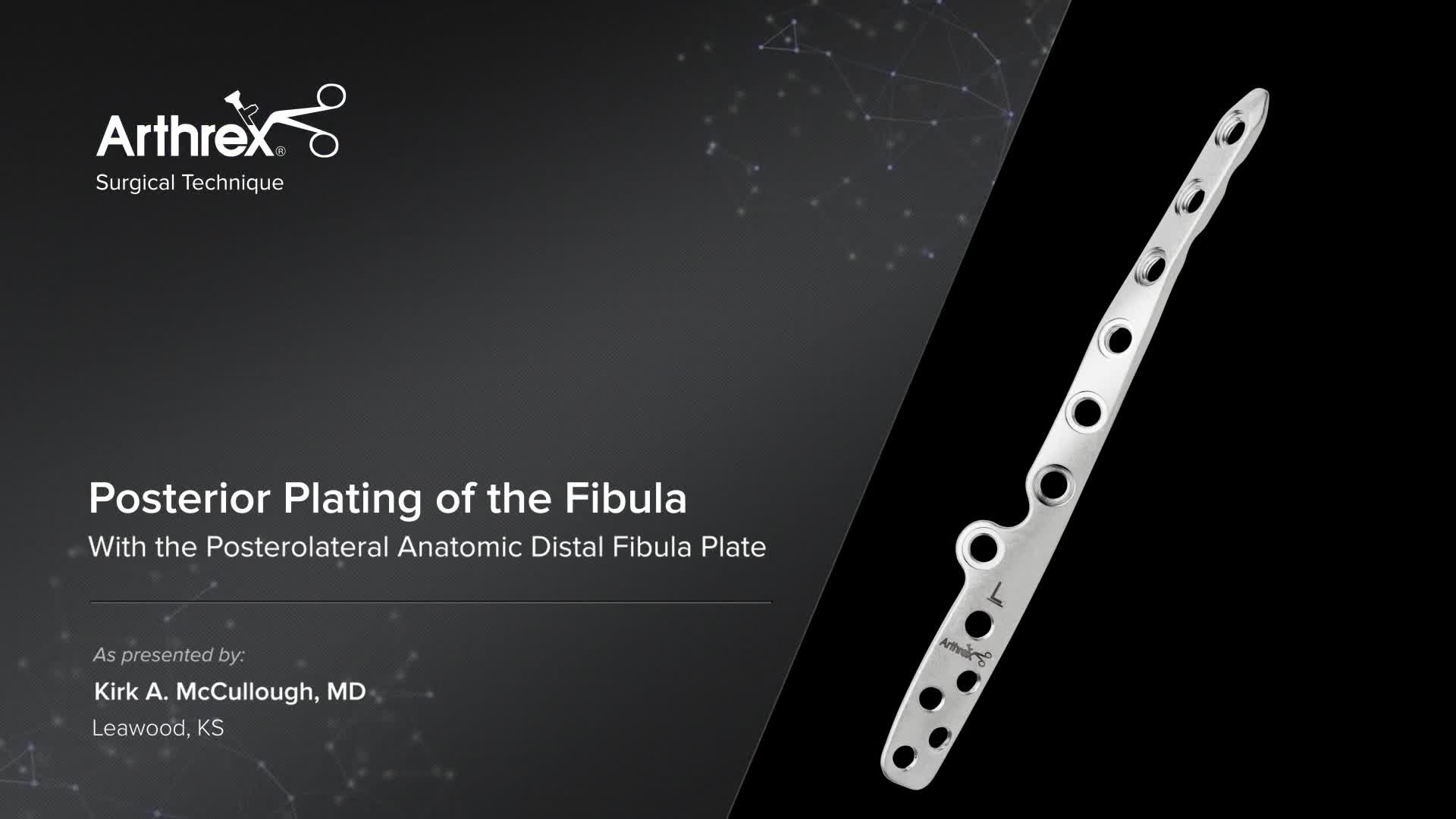 Arthrex - Posterior Plating of the Fibula With the Posterolateral ...