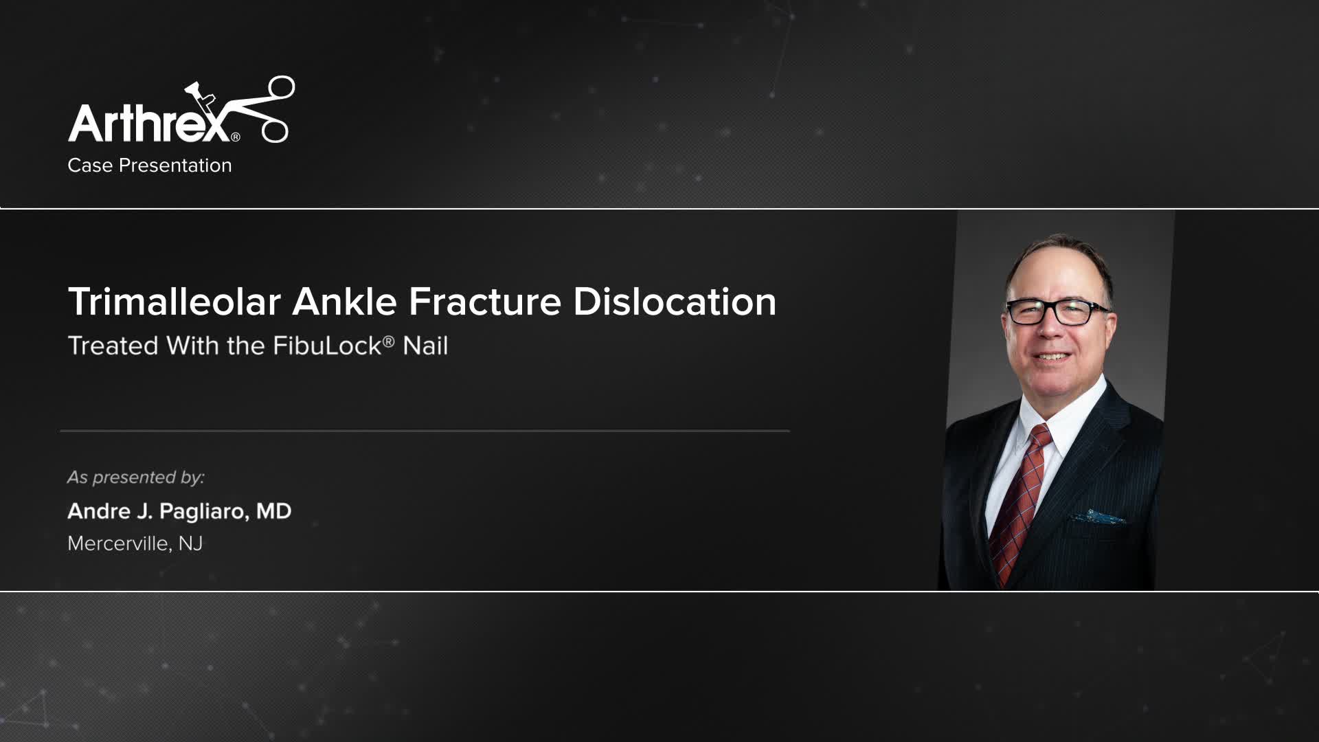 Arthrex - Trimalleolar Ankle Fracture Dislocation Treated With the ...