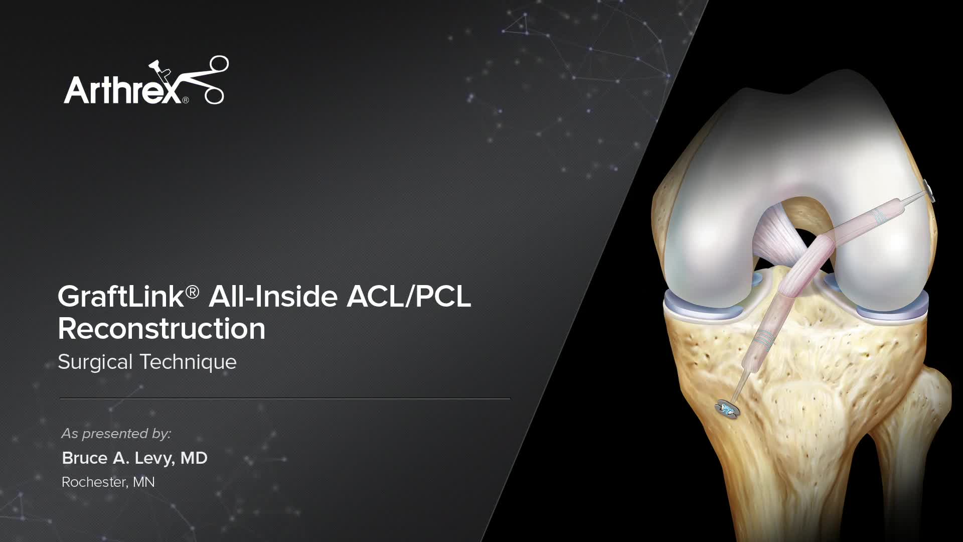 Arthrex - GraftLink® All-Inside ACL/PCL Reconstruction