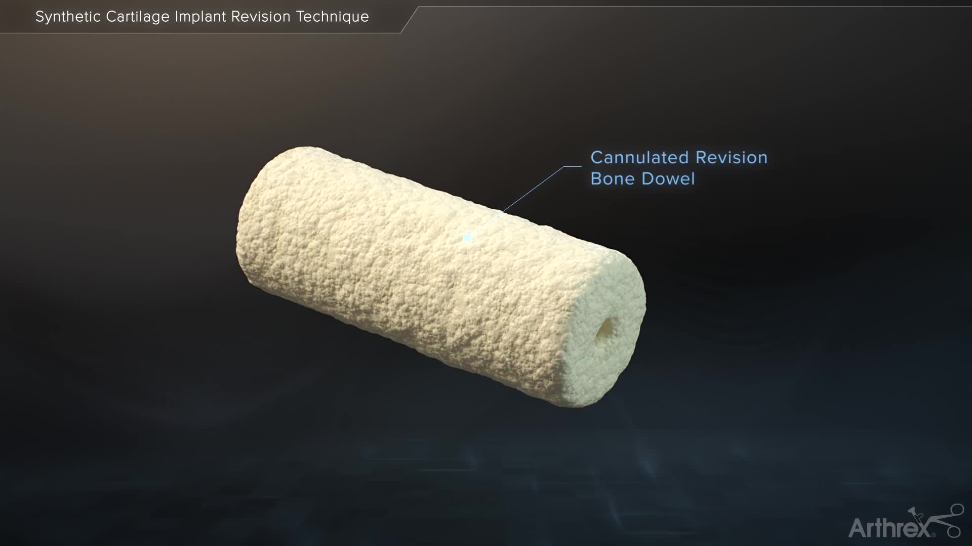 Arthrex - Synthetic Cartilage Implant Revision Technique