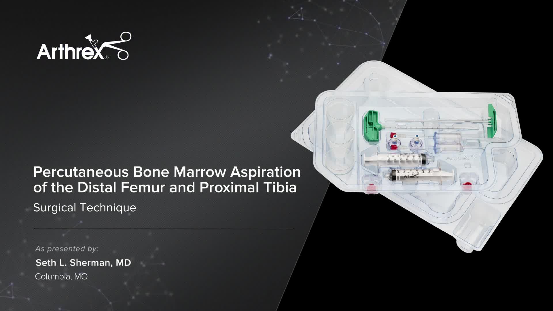 Arthrex - Percutaneous Bone Marrow Aspiration of the Distal Femur and ...
