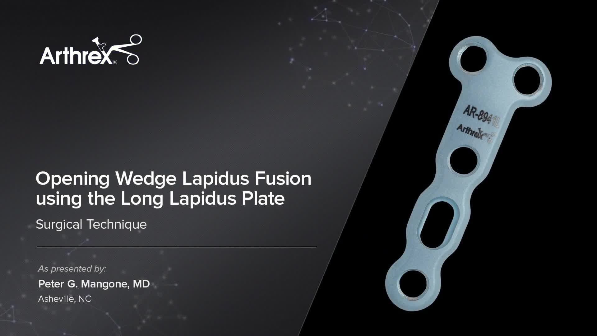 Arthrex - Opening Wedge Lapidus Fusion using the Long Lapidus Plate