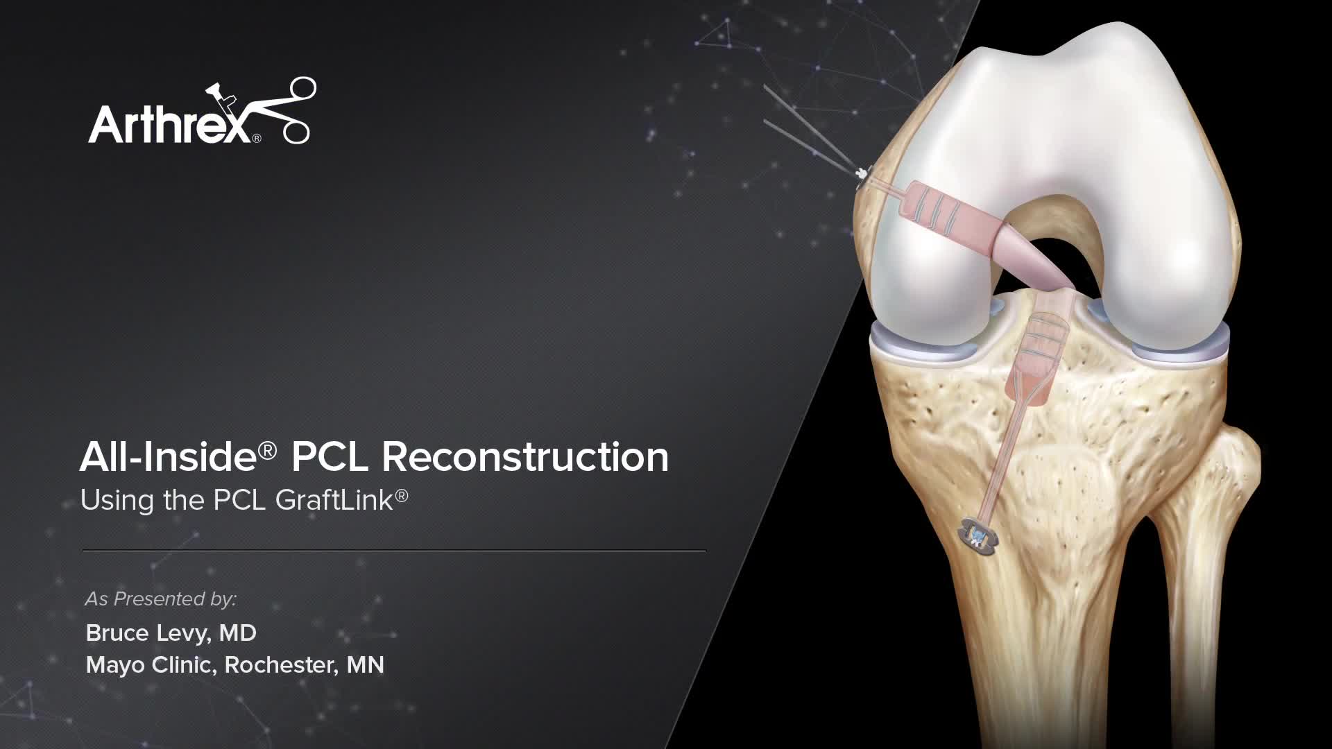 Arthrex - All-Inside PCL Reconstruction: Using the PCL GraftLink®