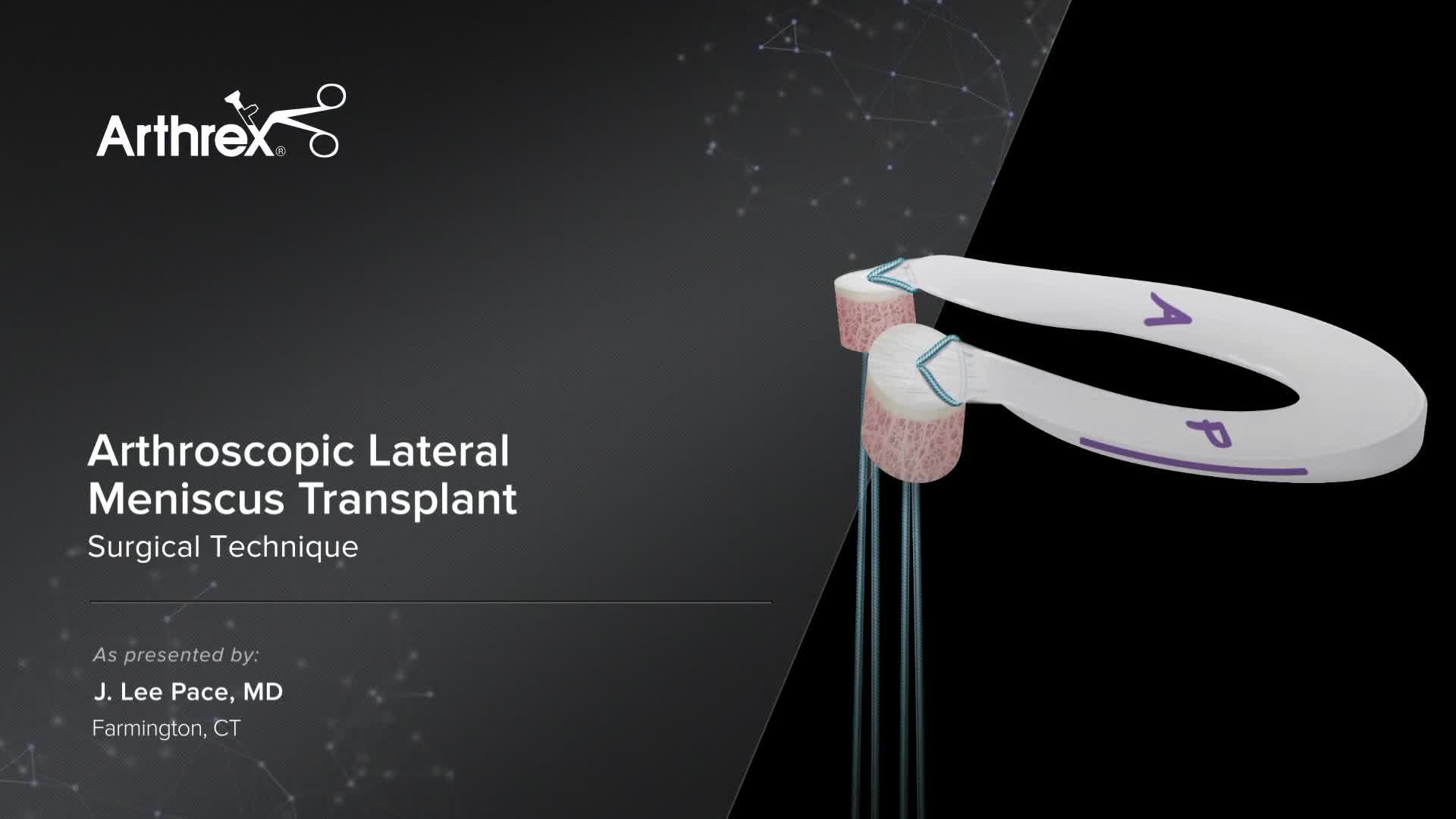Arthrex - Arthroscopic Lateral Meniscus Transplant