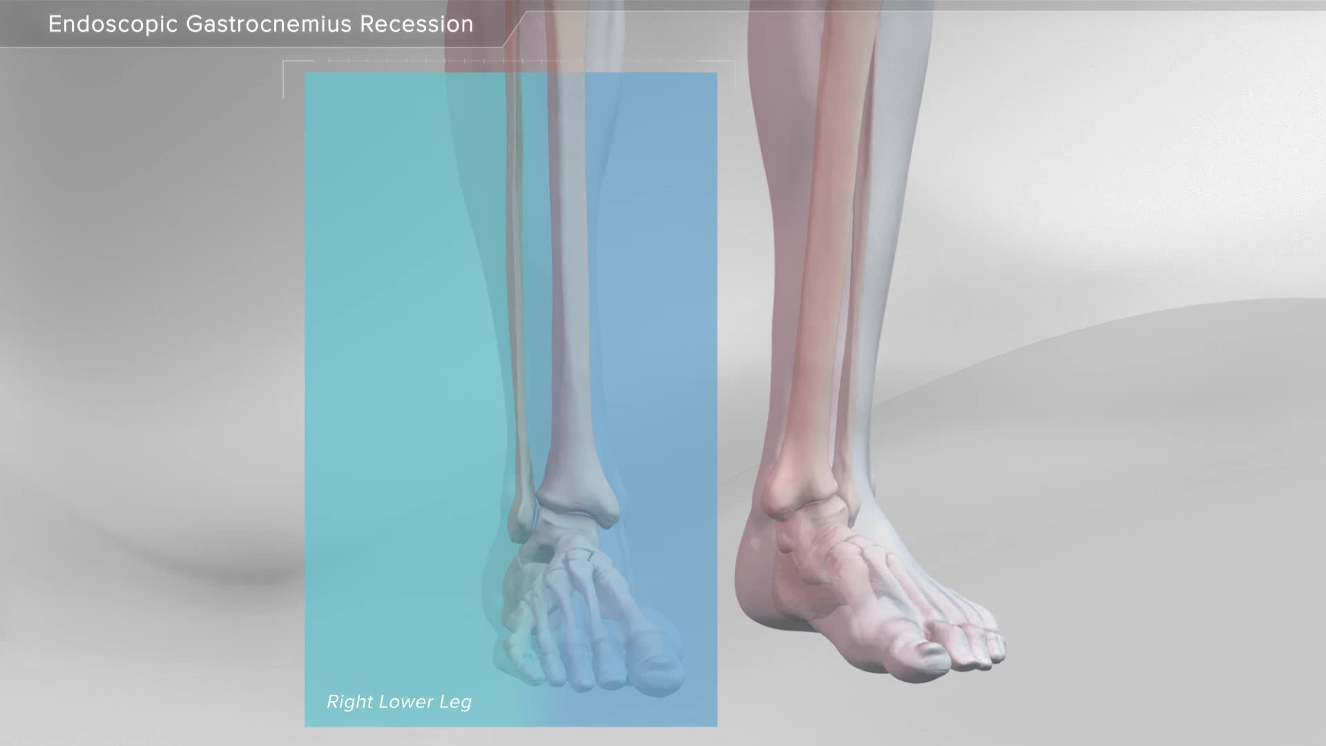 Arthrex - Endoscopic Gastrocnemius Recession