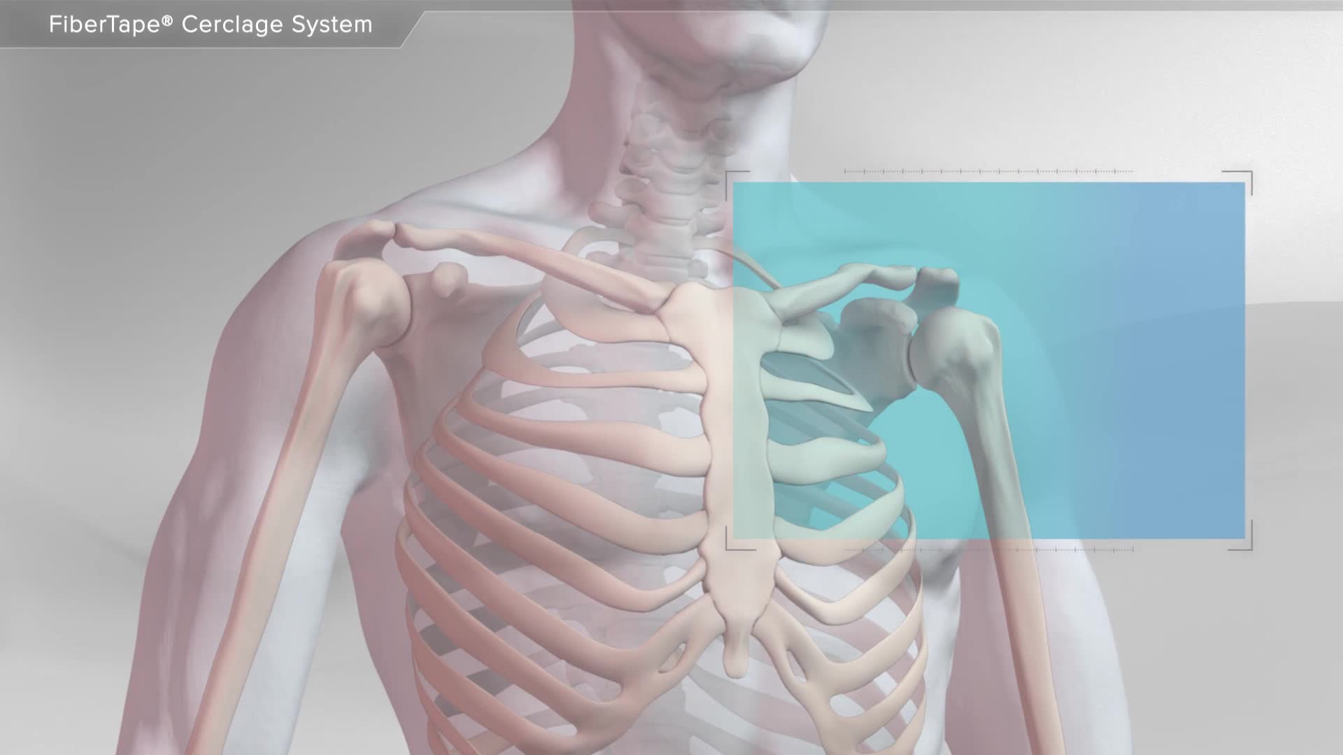 Arthrex - FiberTape® Cerclage System