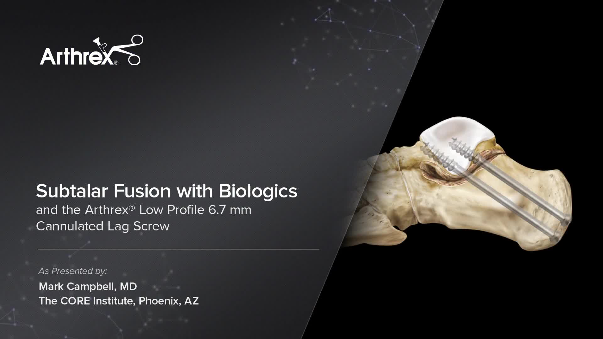 Arthrex - Subtalar Fusion with Biologics and the Arthrex® Low Profile 6 ...