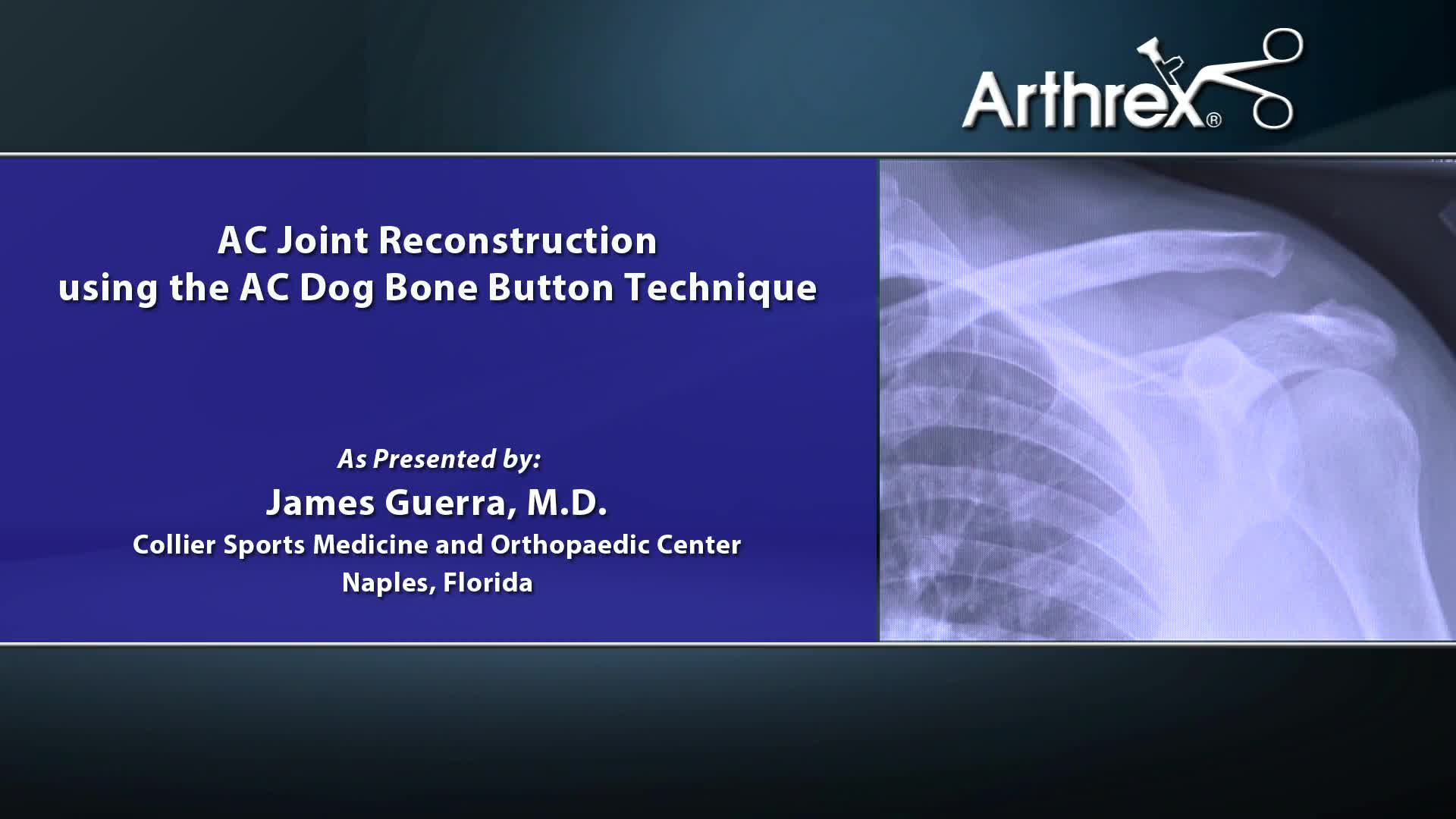 Arthrex - AC Joint Reconstruction Using the Dog Bone™ Button Technique