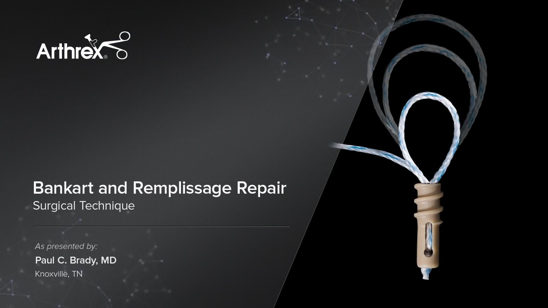 Arthrex - Bankart and Remplissage Repair