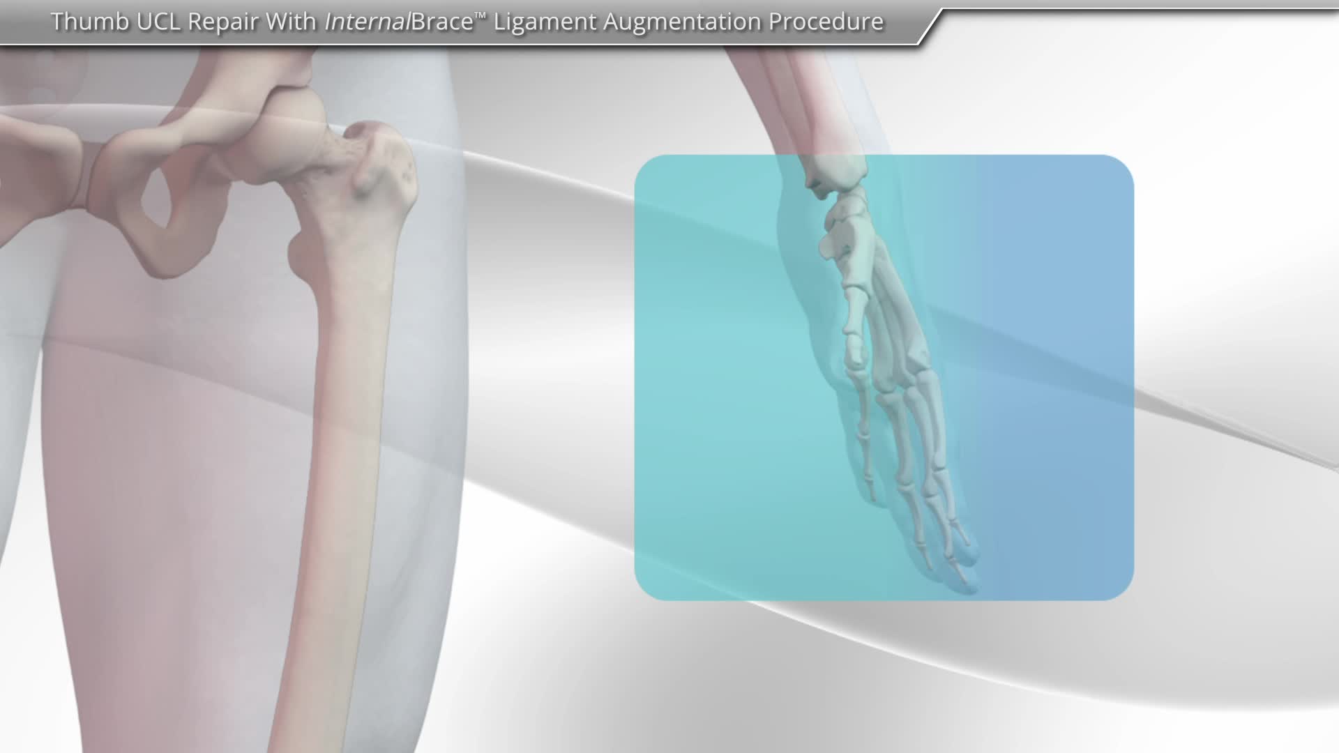 Arthrex - Thumb UCL Repair With InternalBrace™ Ligament Augmentation ...