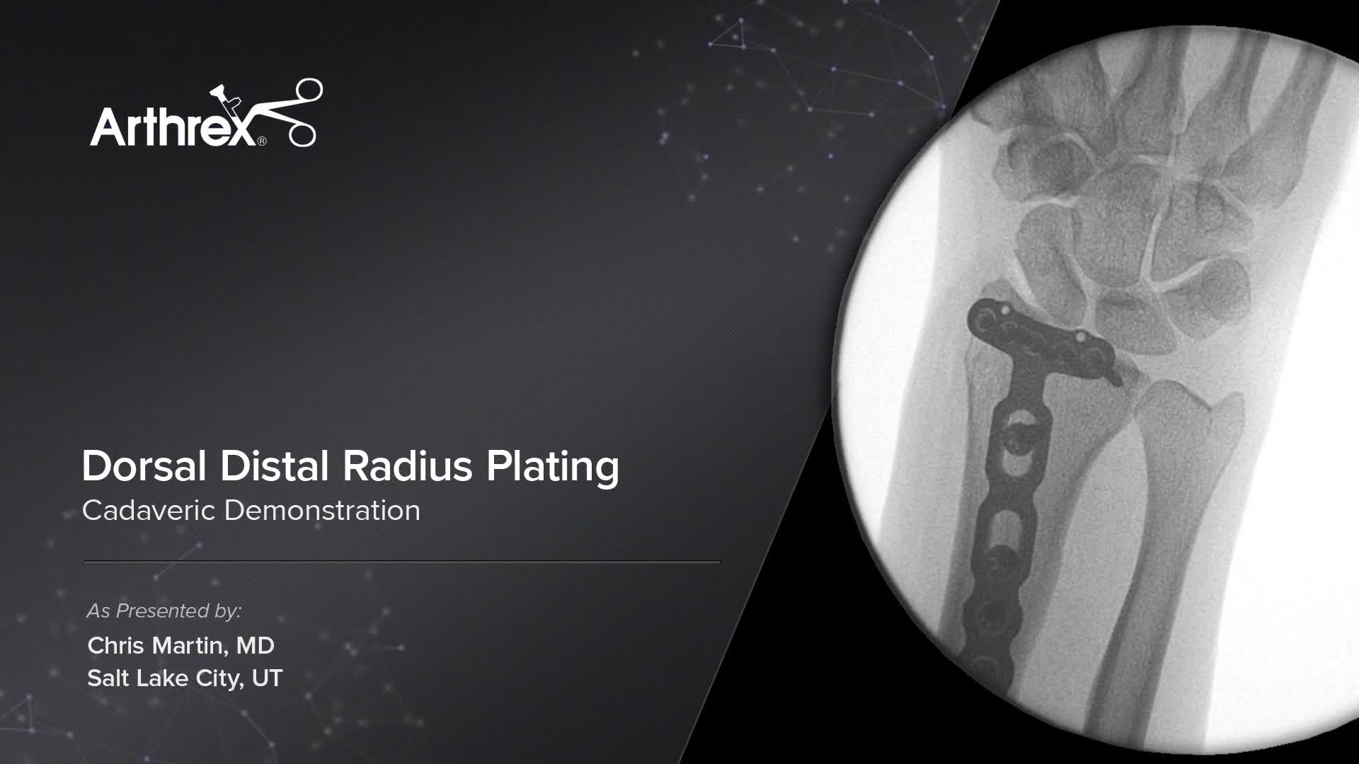 Arthrex - Dorsal Distal Radius Plating