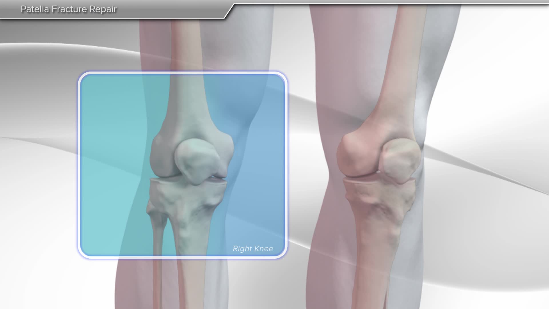 Arthrex - Patella Fracture Repair