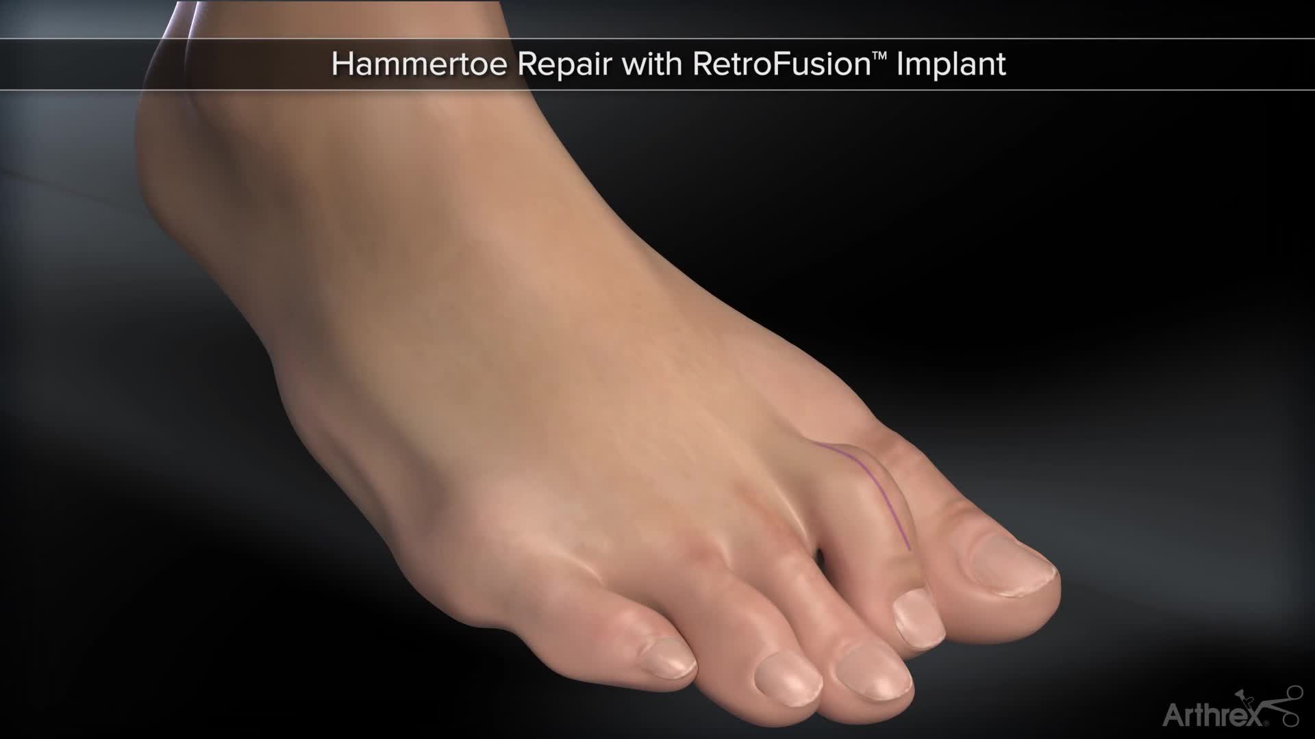 Arthrex - Hammertoe Repair with RetroFusion™ Implant
