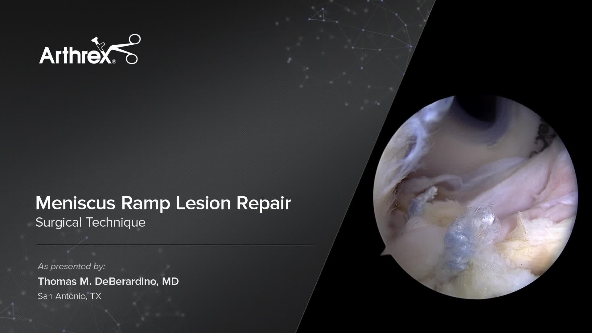 Arthrex - Meniscus Ramp Lesion Repair