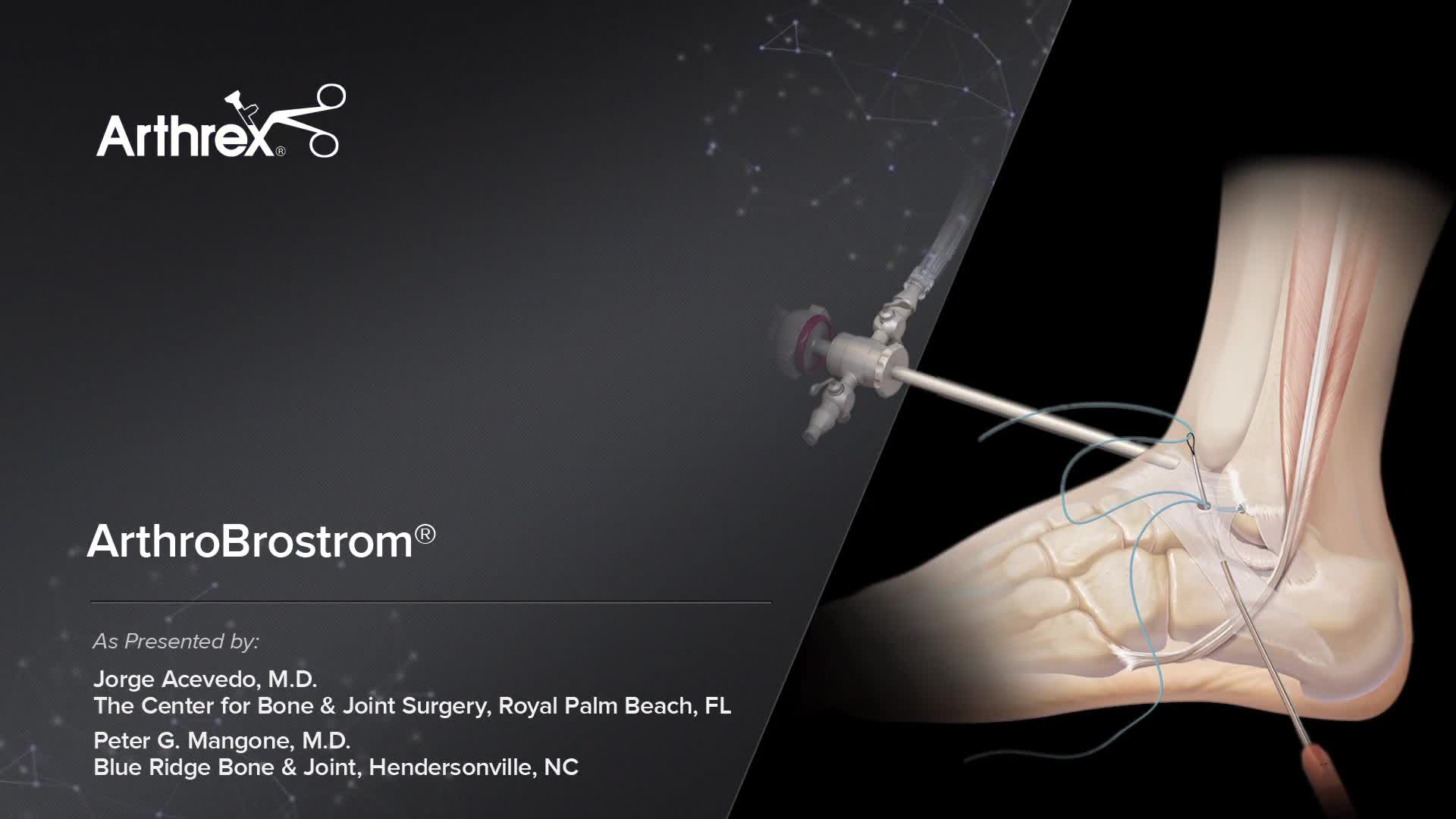 Arthrex - ArthroBrostrom®