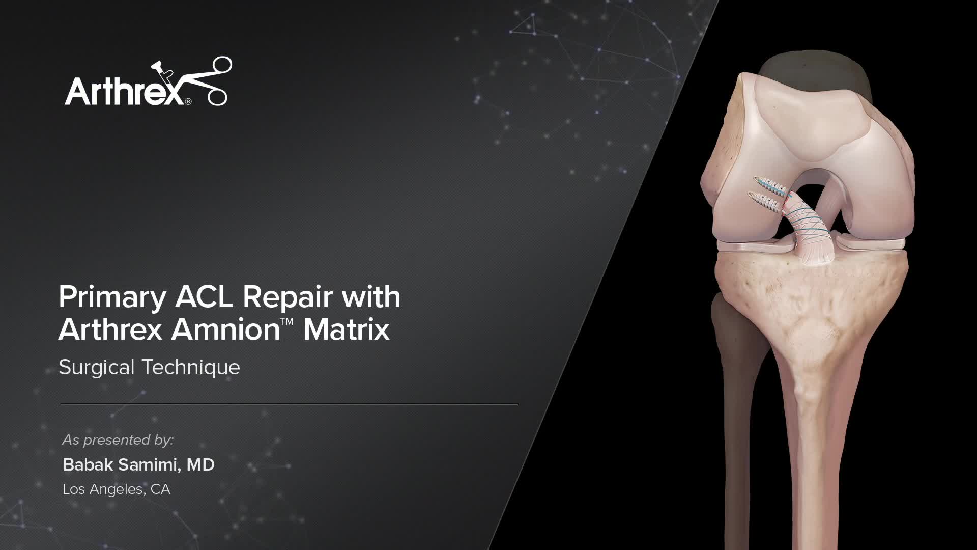Arthrex - Primary ACL Repair with Arthrex Amnion™ Matrix