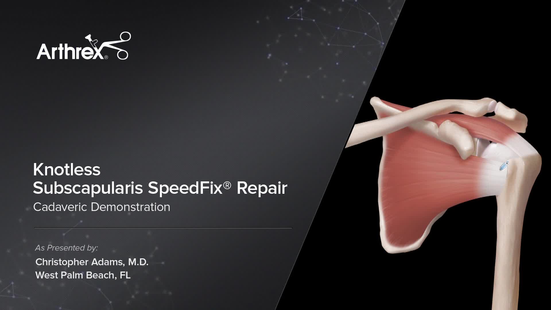 Arthrex - Knotless Subscapularis SpeedFix™ Repair Cadaveric Demonstration