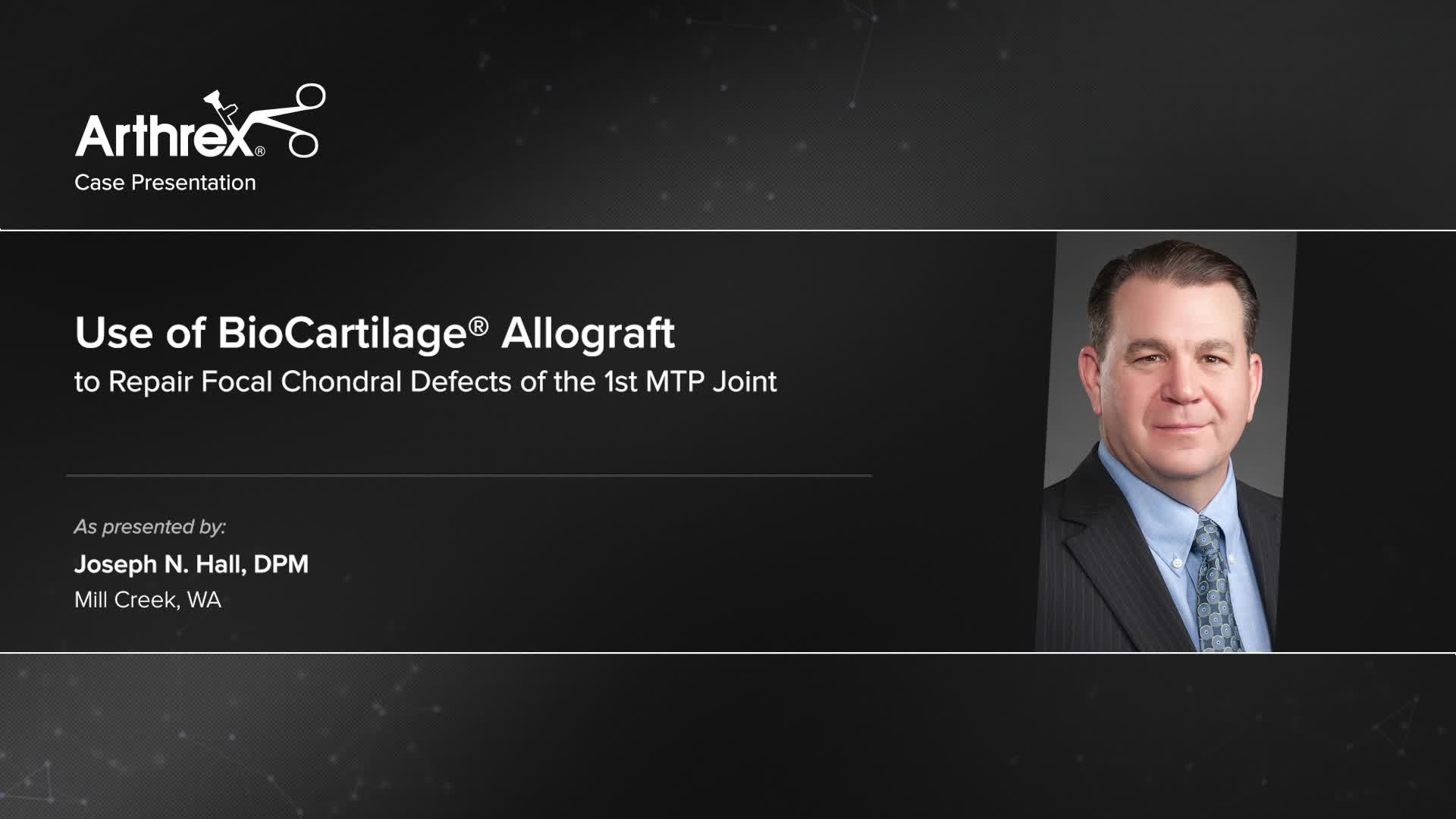 Arthrex - Use of BioCartilage® Allograft to Repair Focal Chondral ...