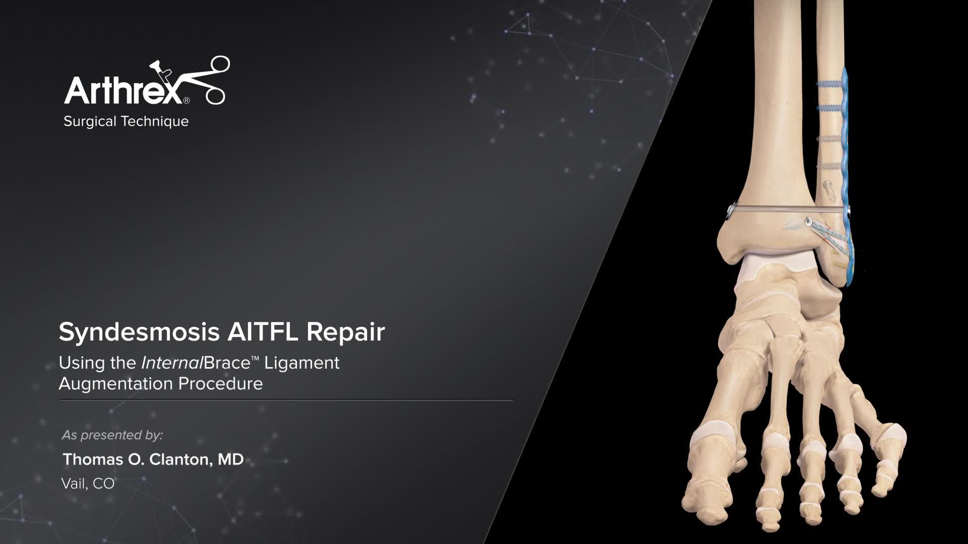 Arthrex - Syndesmosis AITFL Repair Using the InternalBrace™ Procedure