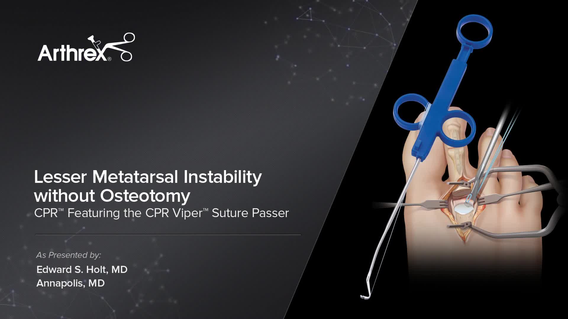 Arthrex - Lesser Metatarsal Instability Without Osteotomy CPR ...