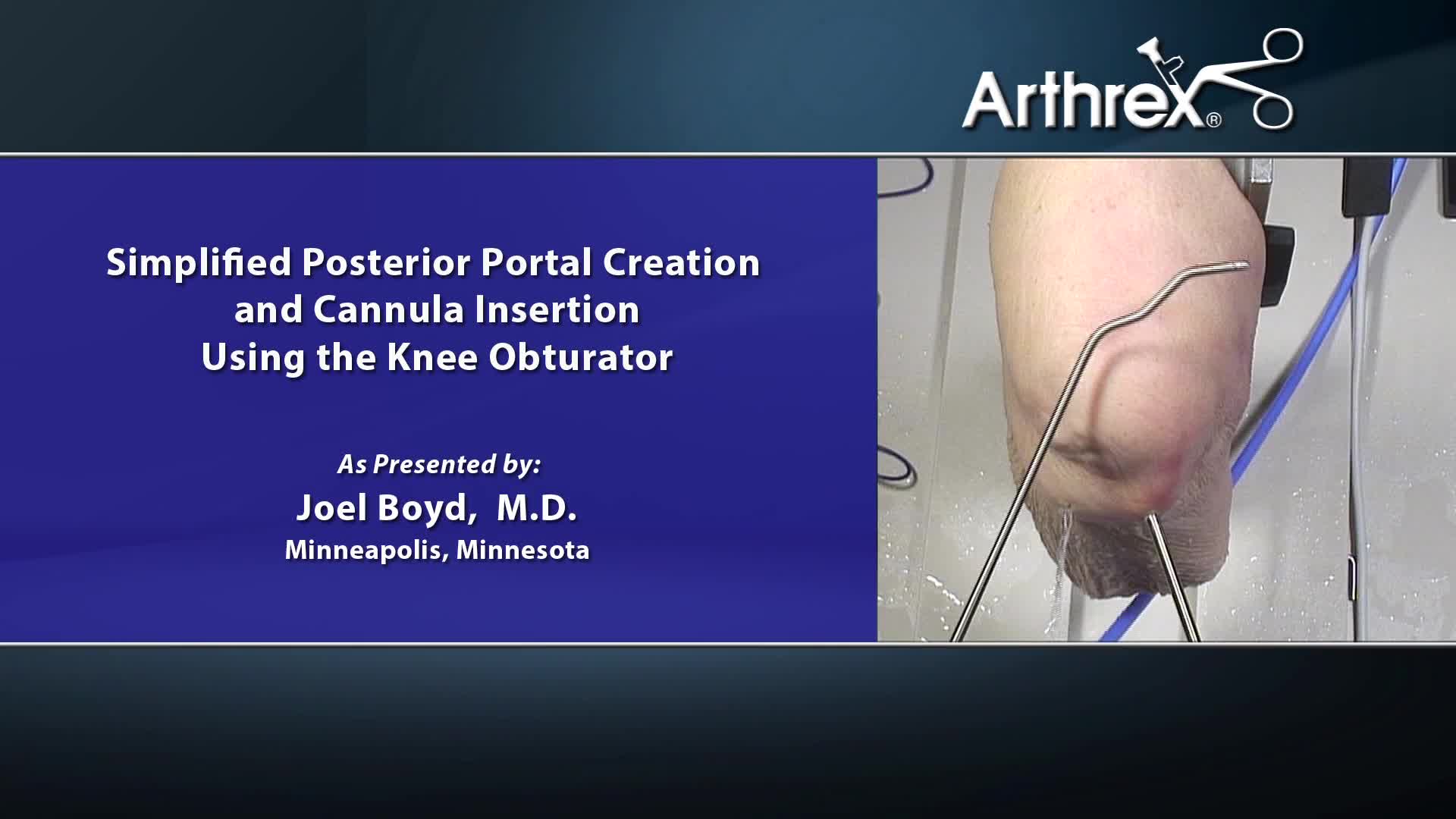 Arthrex - Simplified Posterior Portal Creation and Cannula Insertion ...