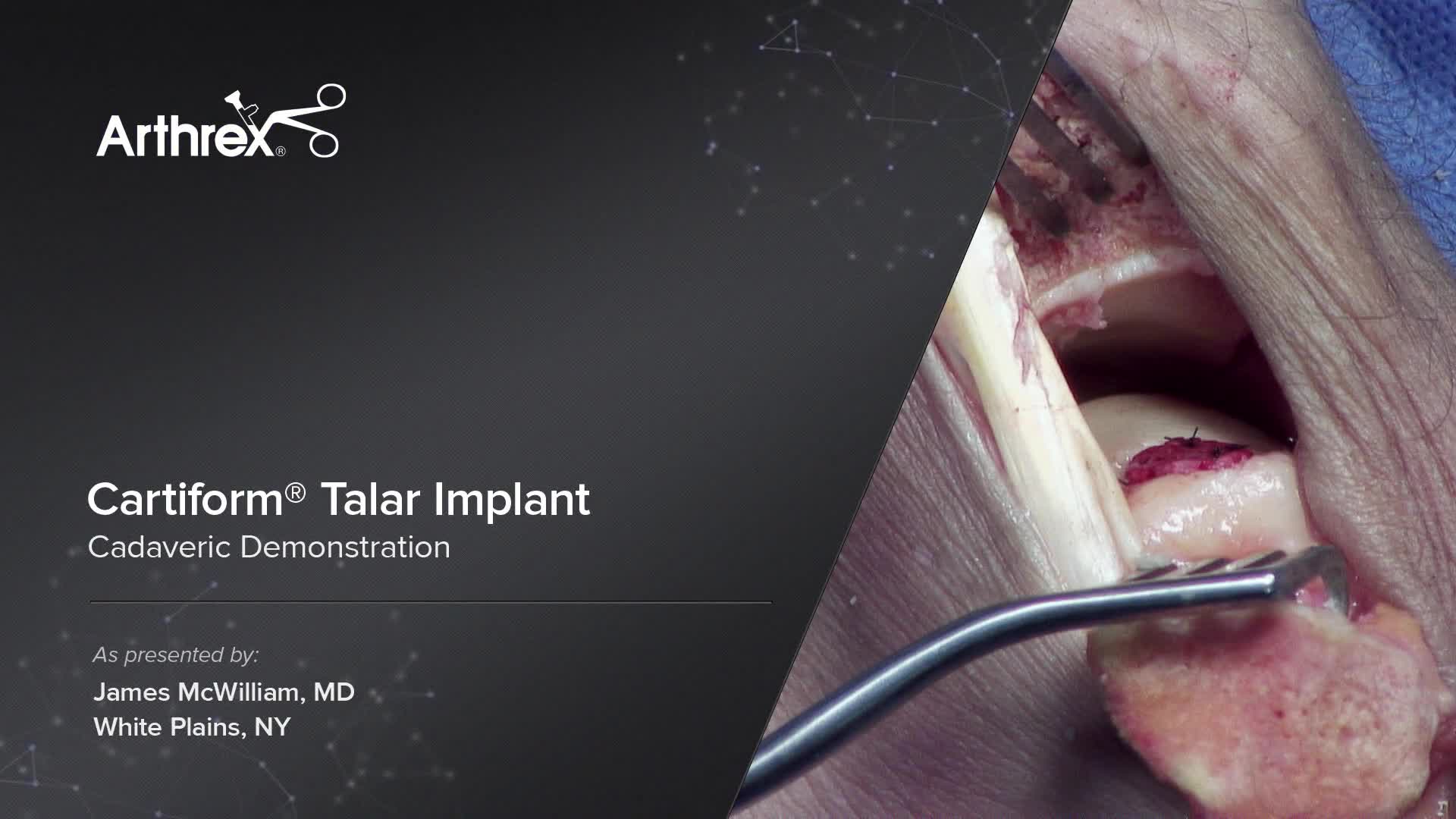 Arthrex - Cartiform® Talar Implant