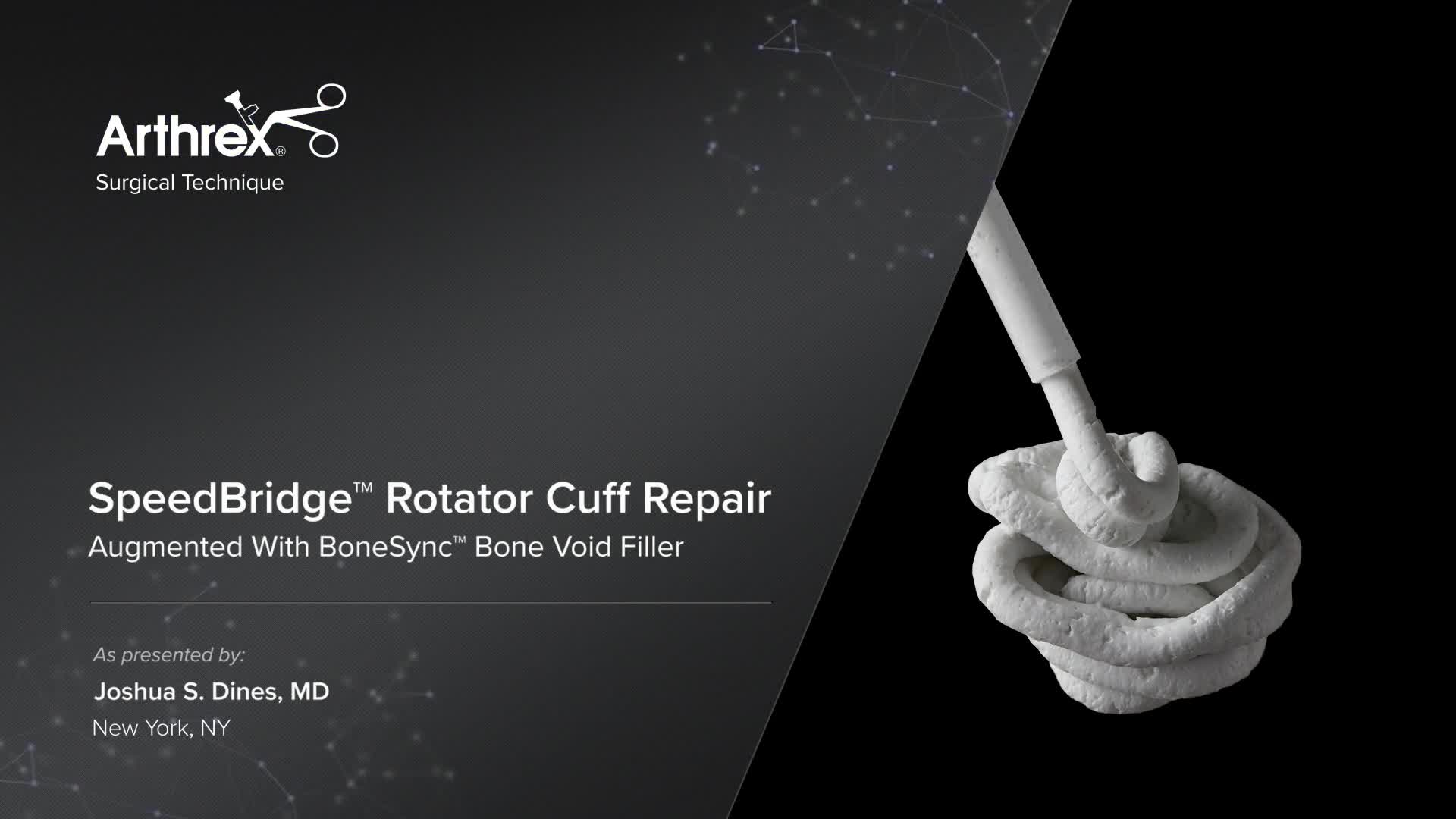 Arthrex - SpeedBridge™ Rotator Cuff Repair Augmented With BoneSync ...