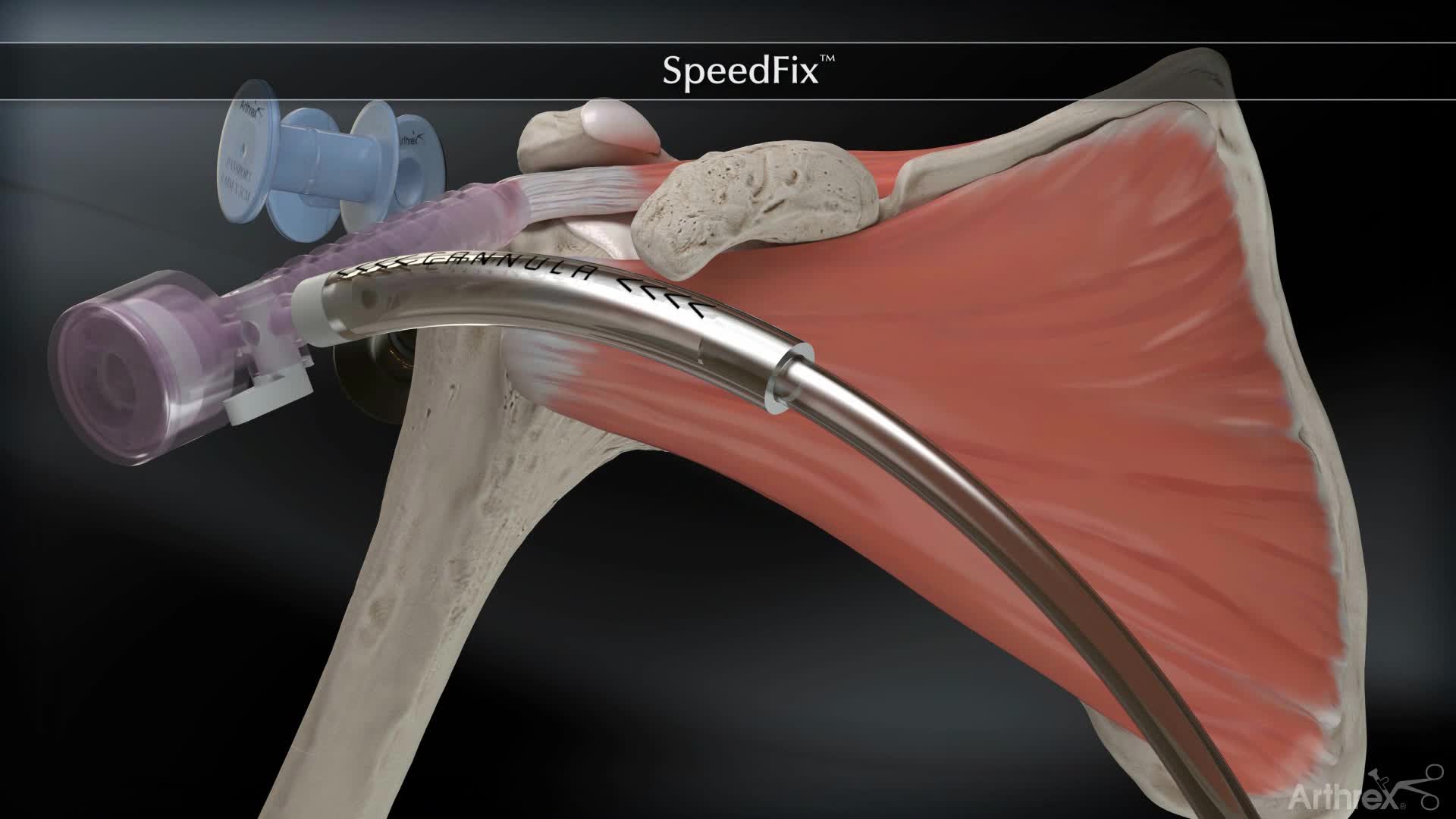 Arthrex - SpeedFix™