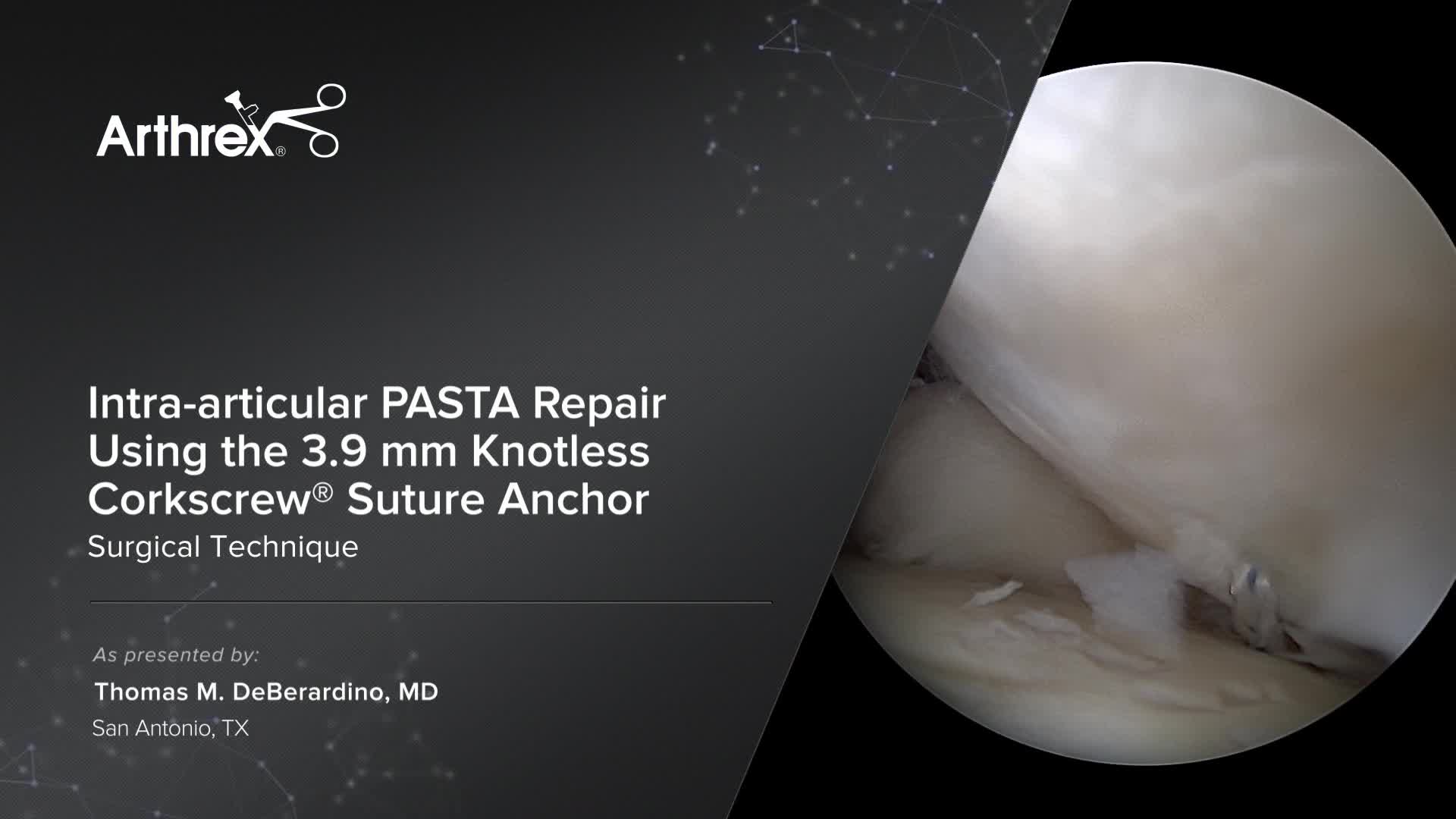 Arthrex - Intra-articular PASTA Repair Using the 3.9 mm Knotless ...
