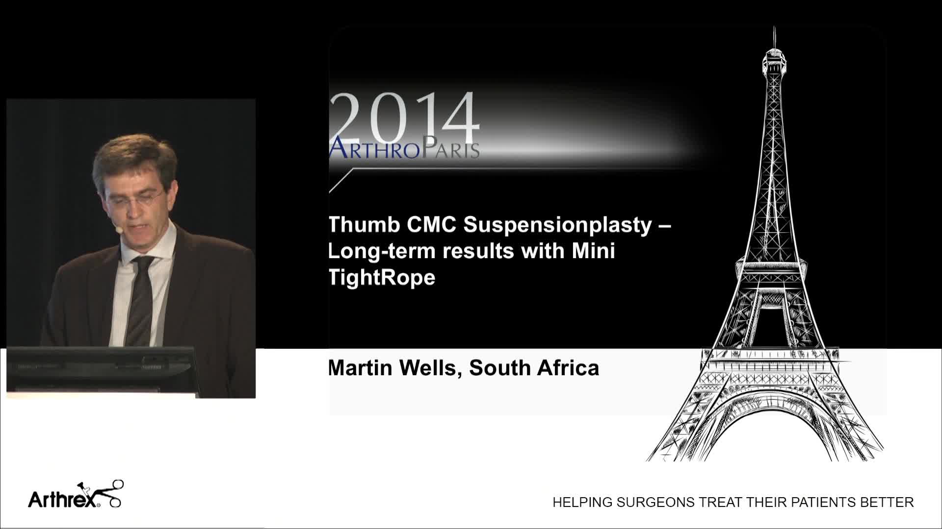 Arthrex - Thumb CMC Suspensionplasty - Long-term results with Mini ...