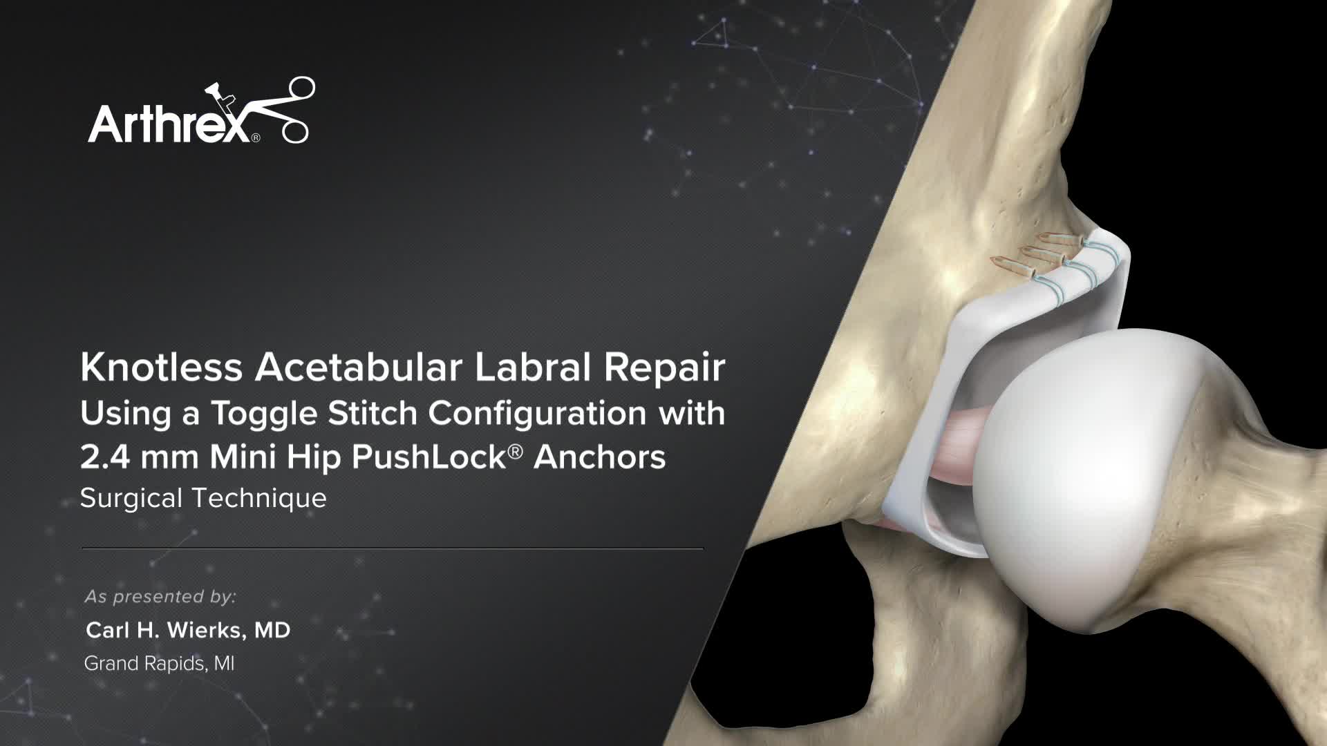 Arthrex - Knotless Acetabular Labral Repair Using a Toggle Stitch ...