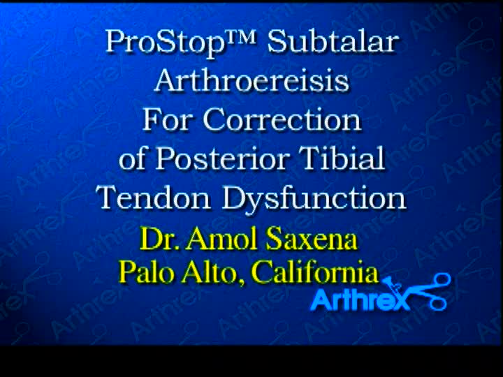 Arthrex - ProStop® Subtalar Arthroereisis For Correction of Posterior ...