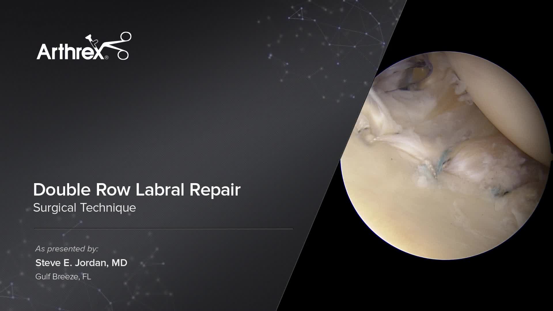 Arthrex - Double Row Labral Repair