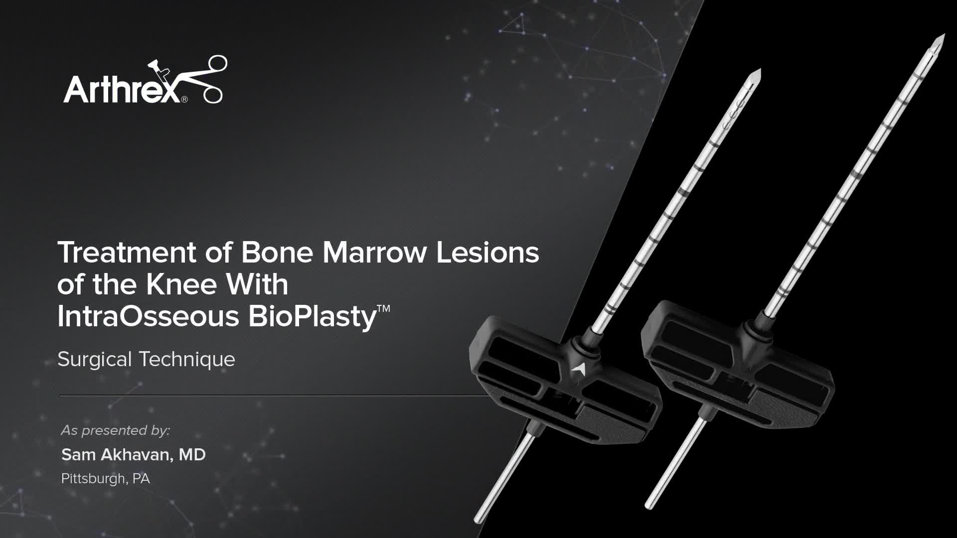 Arthrex - Treatment of Bone Marrow Lesions of the Knee With ...