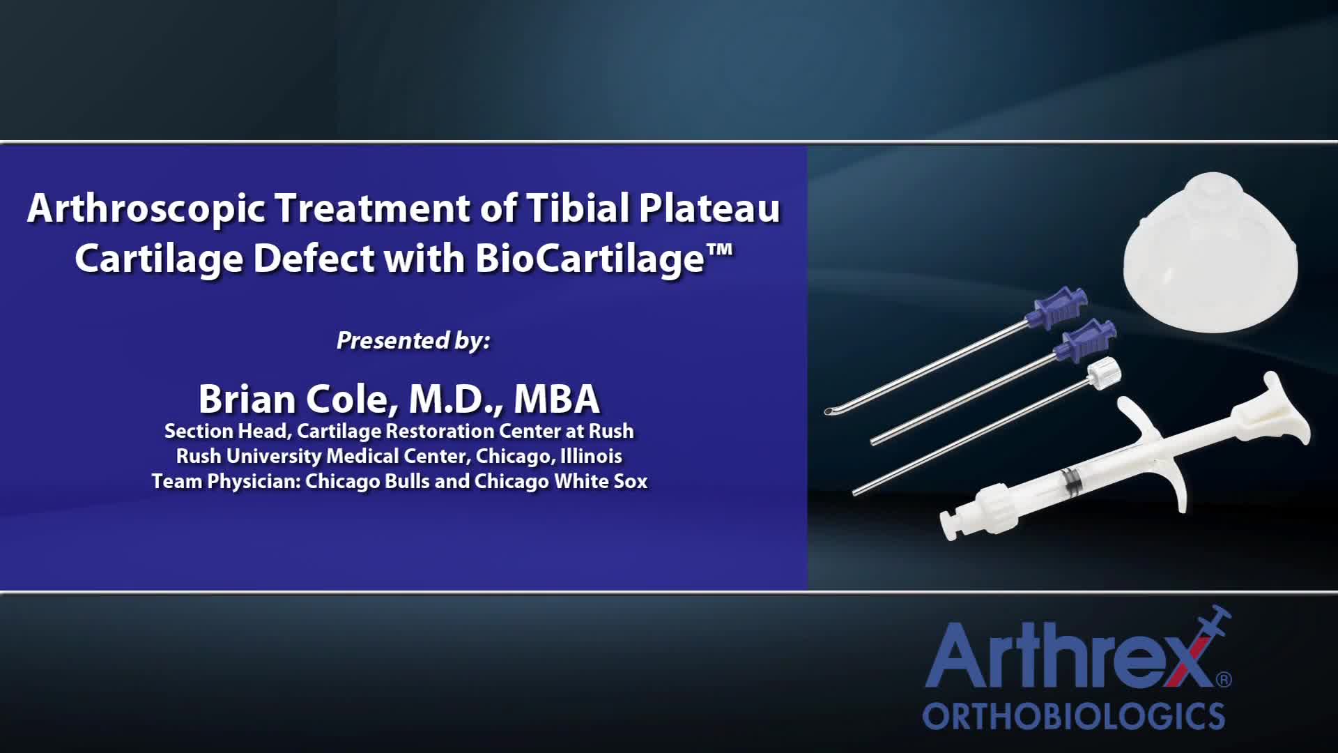 Arthrex - Arthroscopic Treatment of Tibial Plateau Cartilage Defect ...