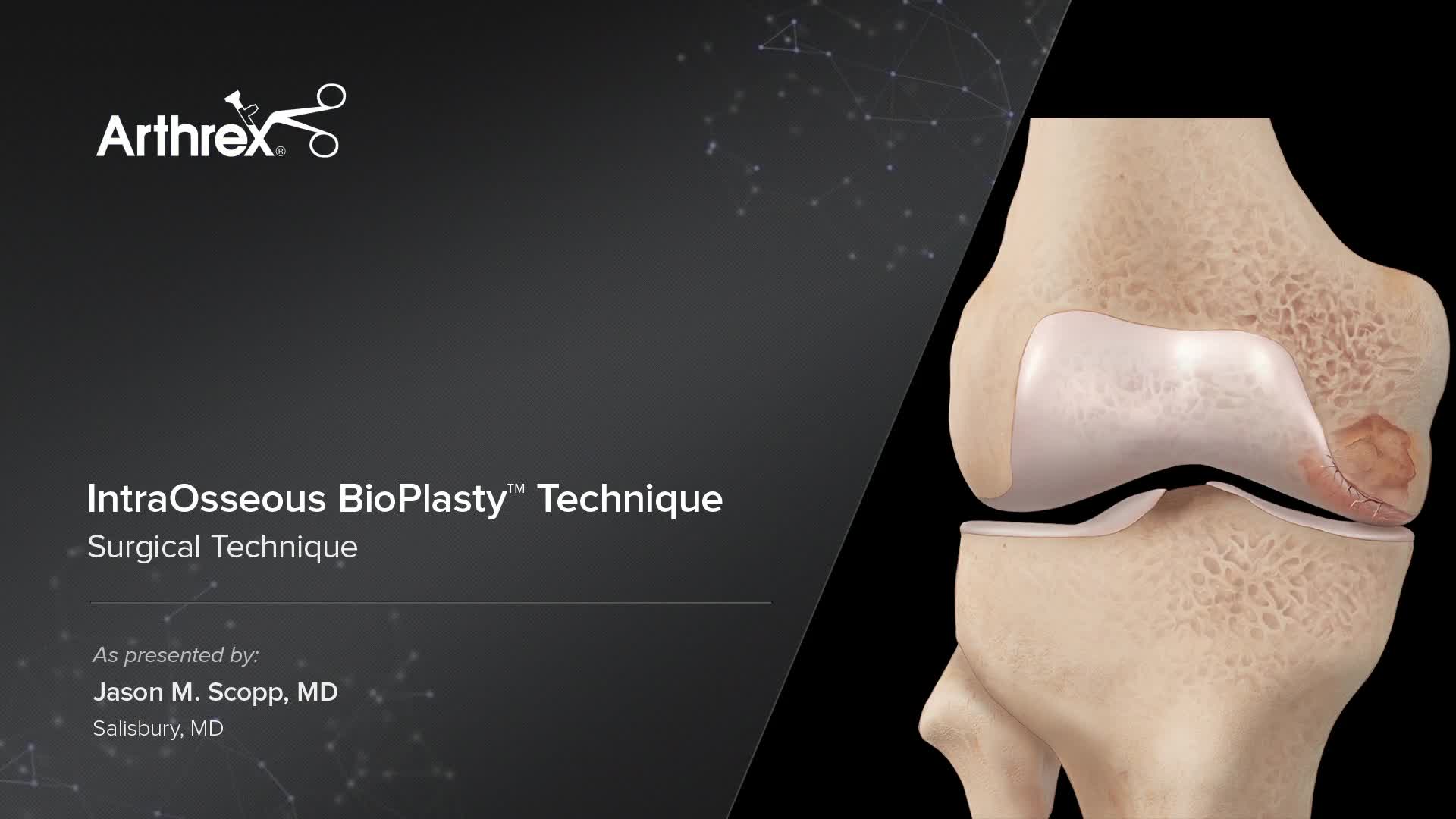 Arthrex - IntraOsseous BioPlasty™ Technique