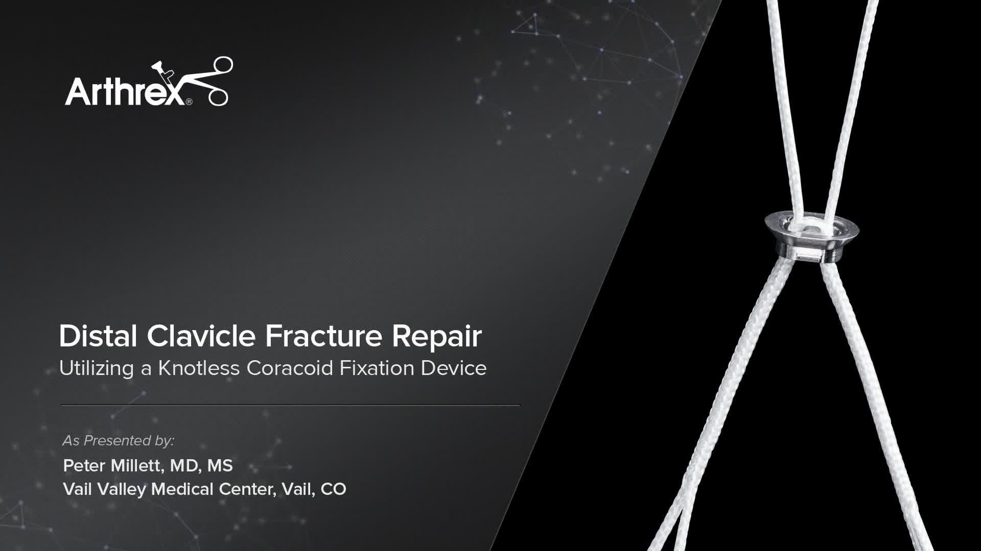 Arthrex - Distal Clavicle Fracture Repair - Utilizing a Knotless ...