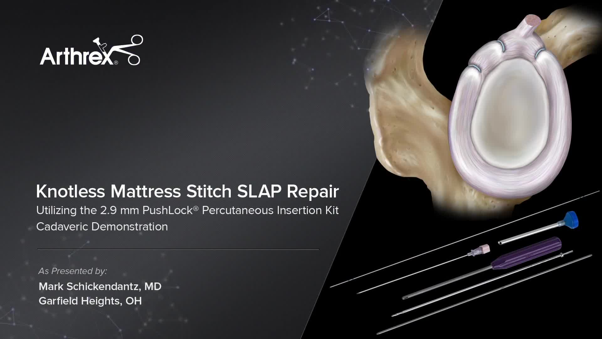 Arthrex - Knotless Mattress Stitch SLAP Repair Utilizing the 2.9 mm ...