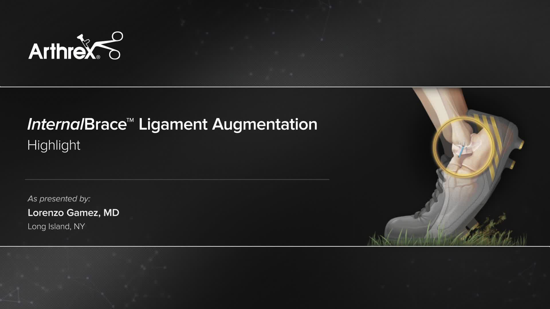 Arthrex - InternalBrace™ Ligament Augmentation