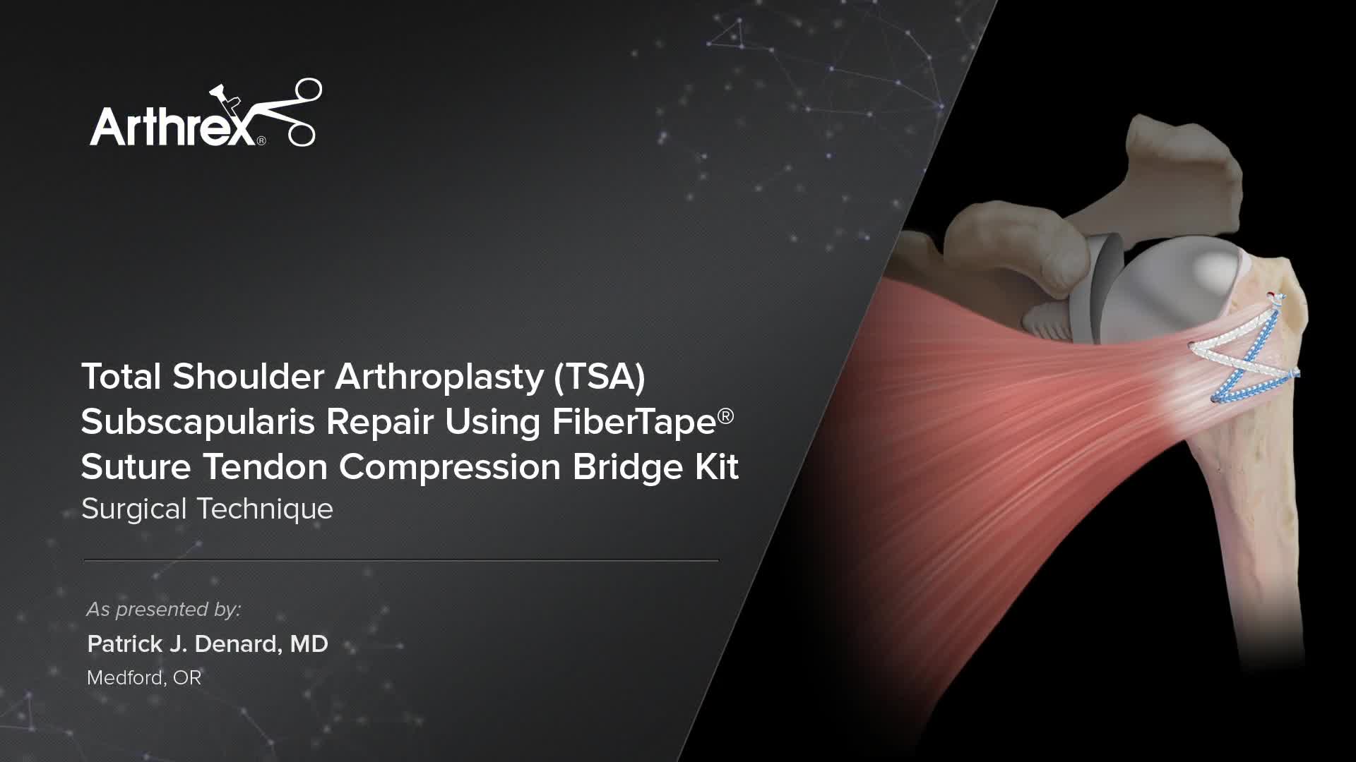 Arthrex - Total Shoulder Arthroplasty (TSA) Subscapularis Repair Using ...