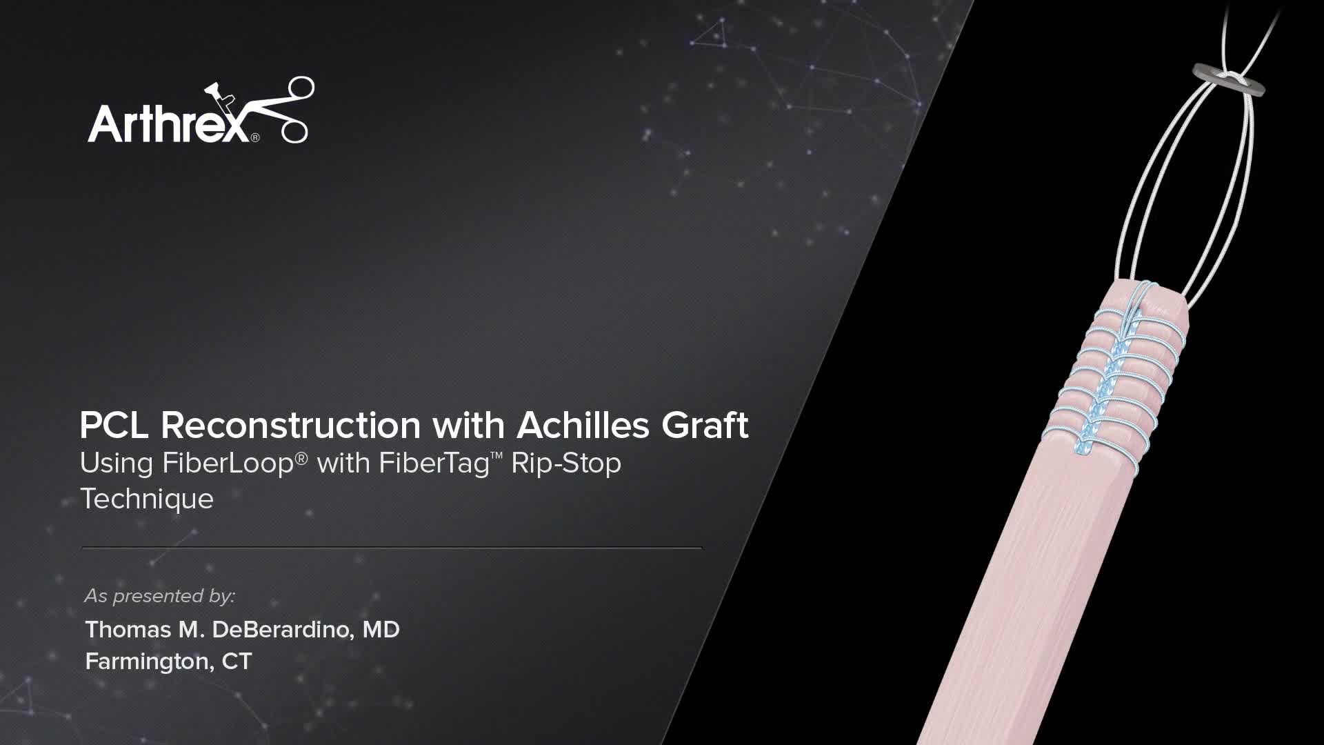Arthrex - PCL Reconstruction with Achilles Graft Using FiberLoop® with ...