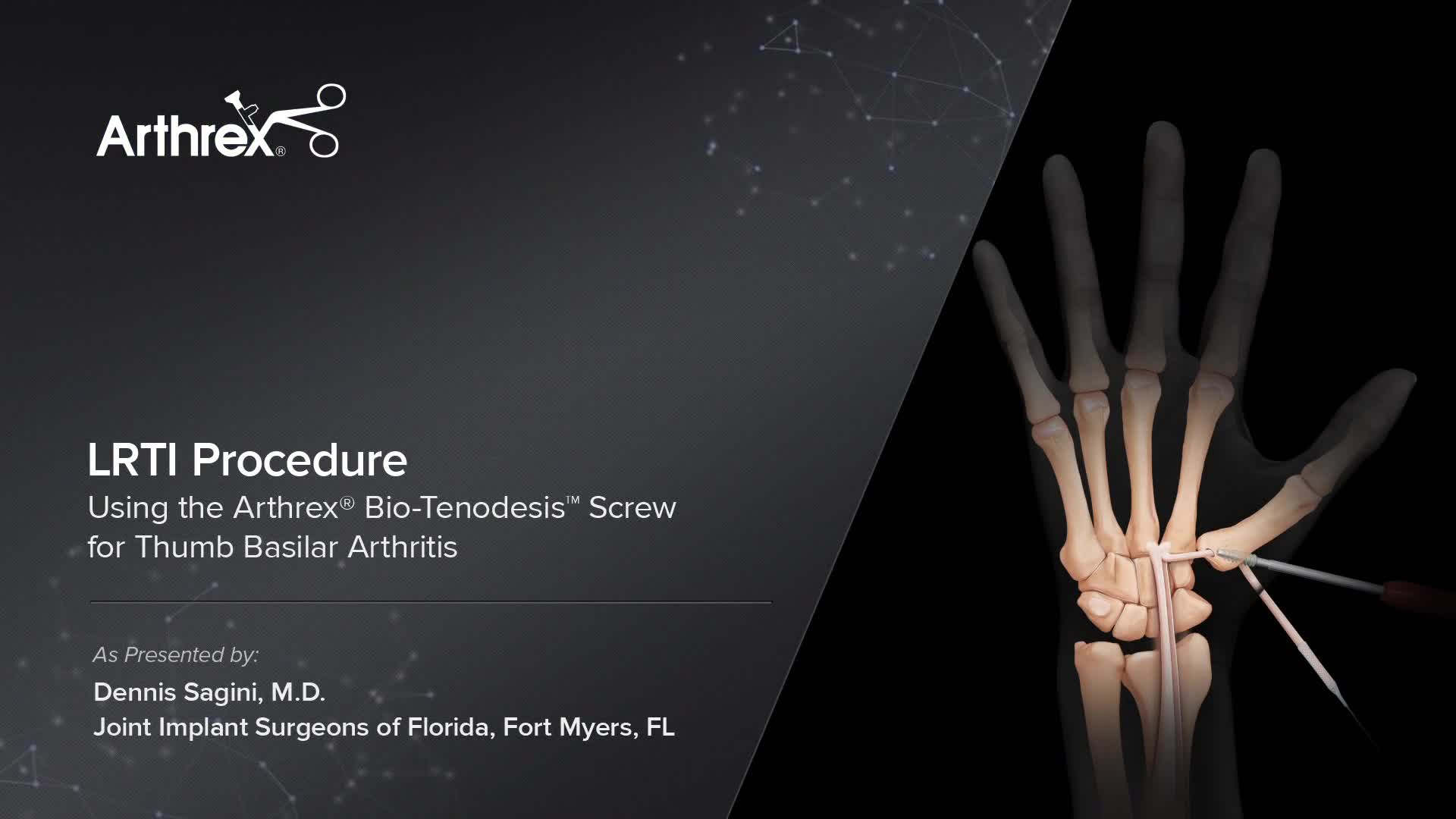 Arthrex - LRTI Procedure Using the Arthrex Bio-Tenodesis™ Screw for ...