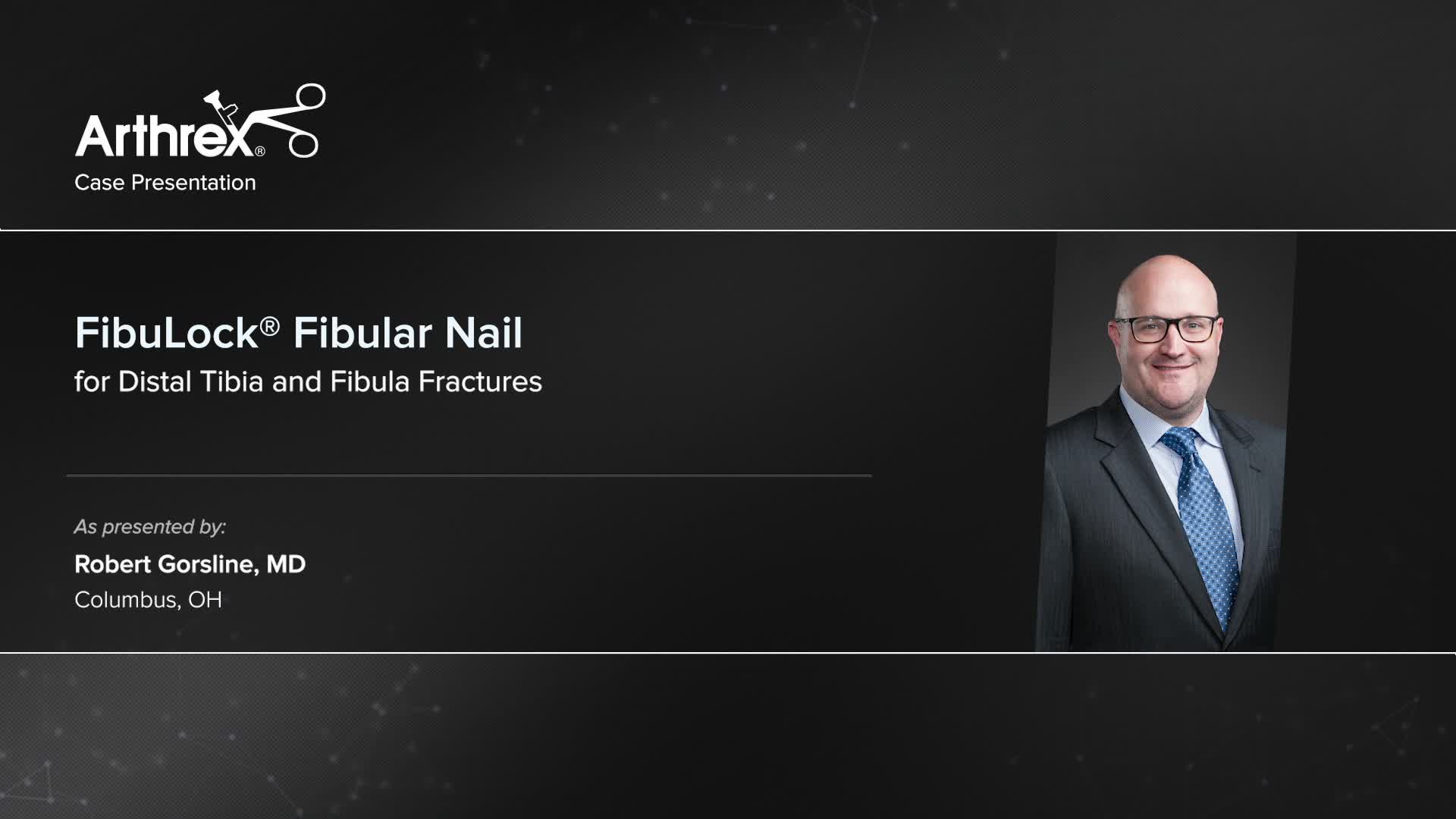 Arthrex - FibuLock® Fibular Nail for Distal Tibia and Fibula Fractures