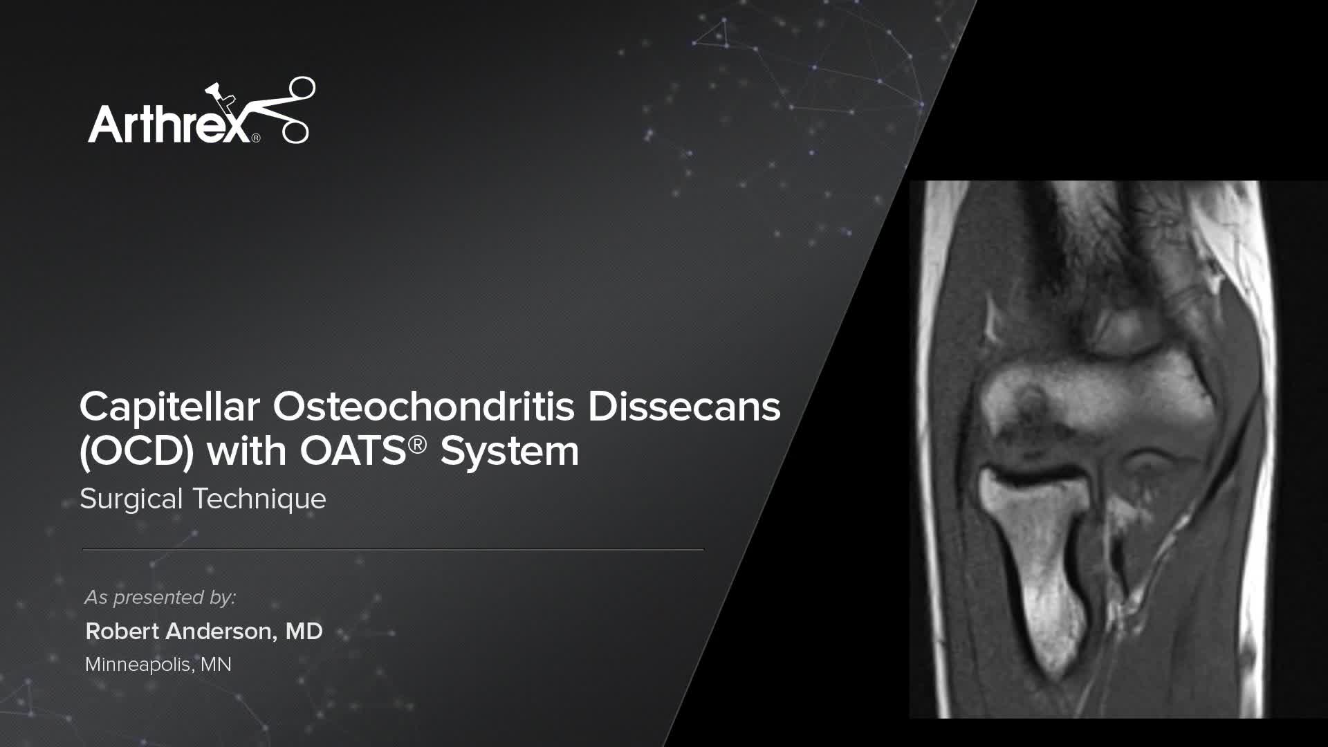 Arthrex - Capitellar Osteochondritis Dissecans (OCD) with OATS® System