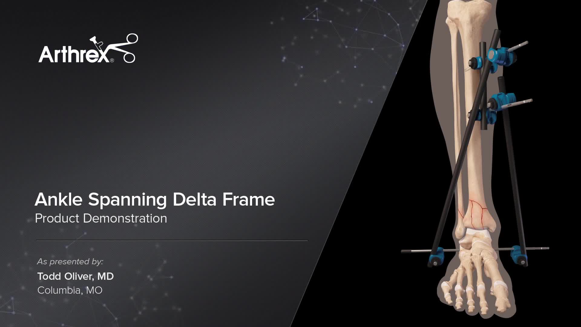 Arthrex - Ankle Spanning Delta Frame