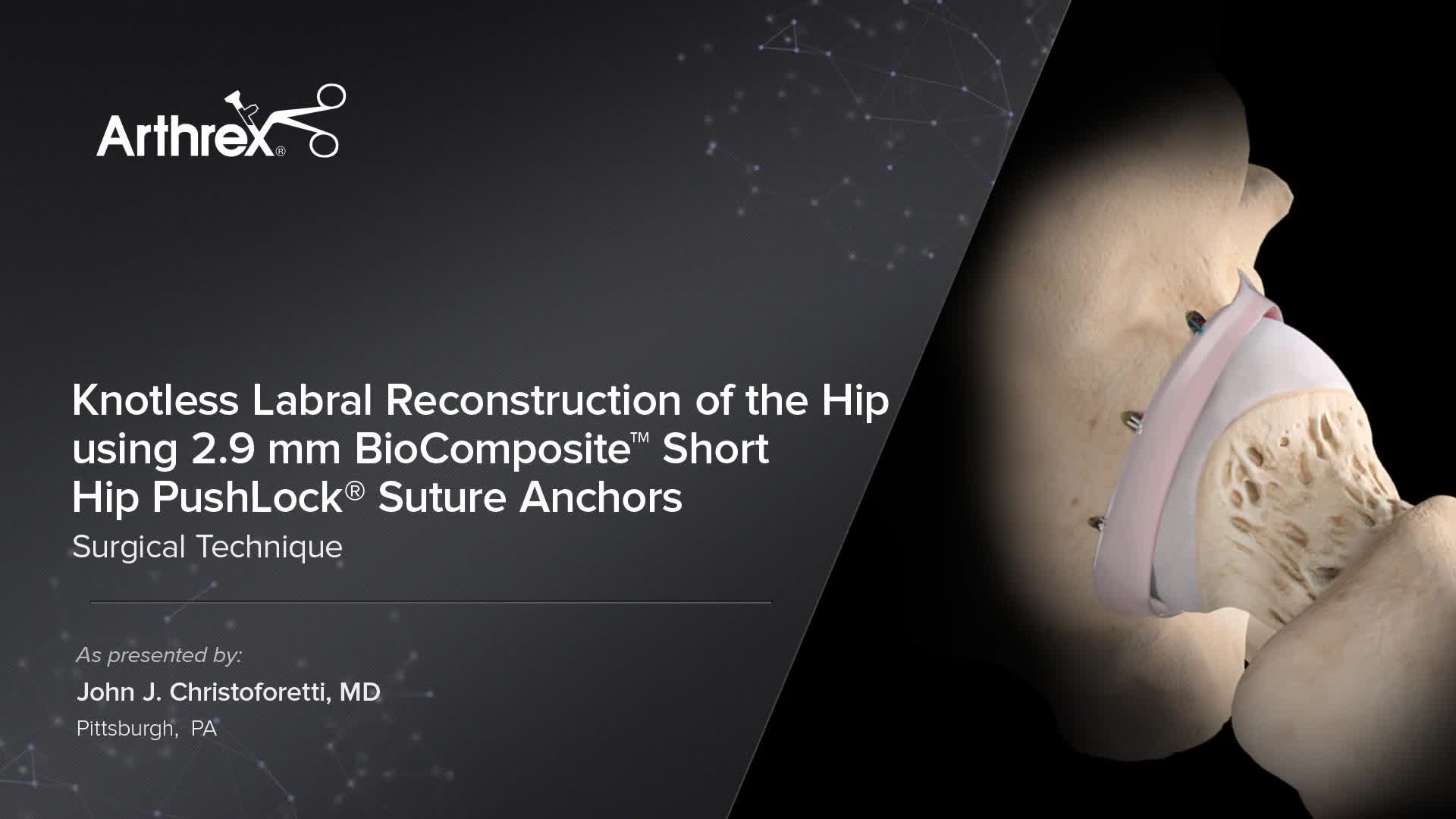 Arthrex - Knotless Labral Reconstruction of the Hip using 2.9 mm ...