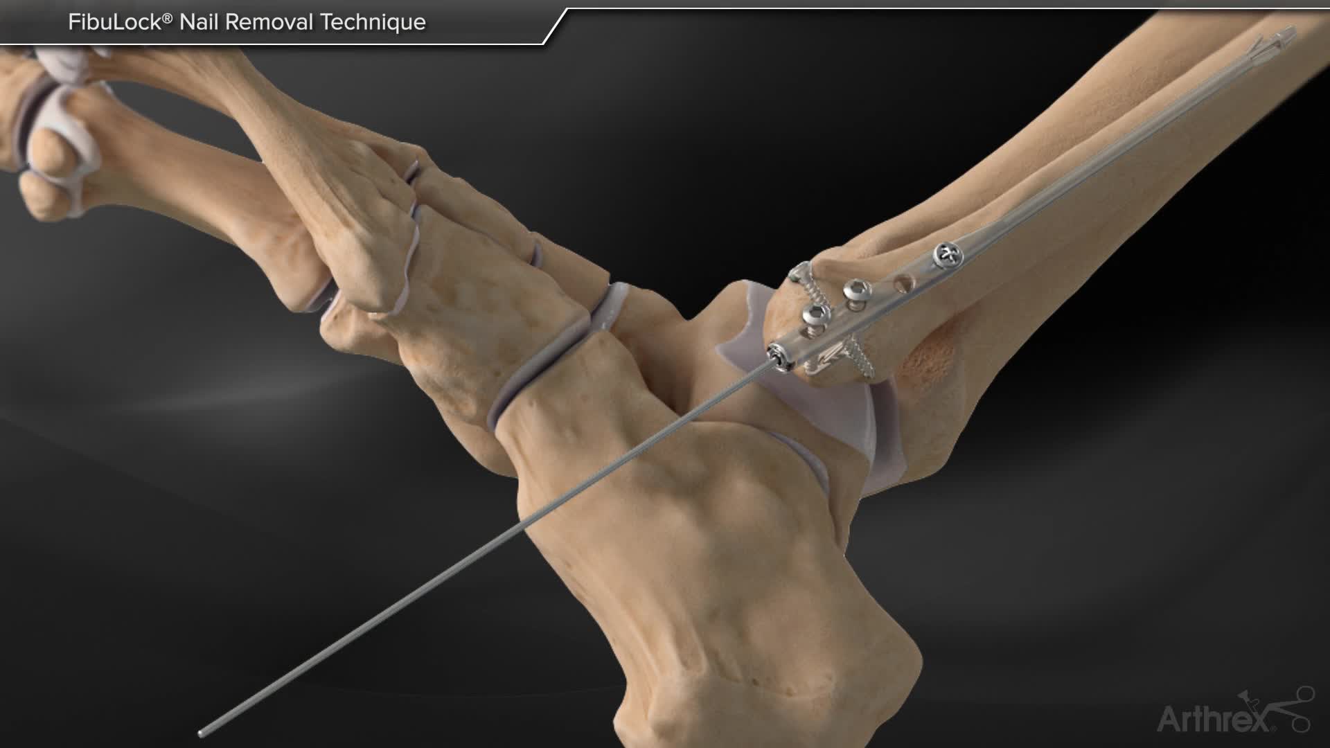 Arthrex - FibuLock® Nail Removal Technique
